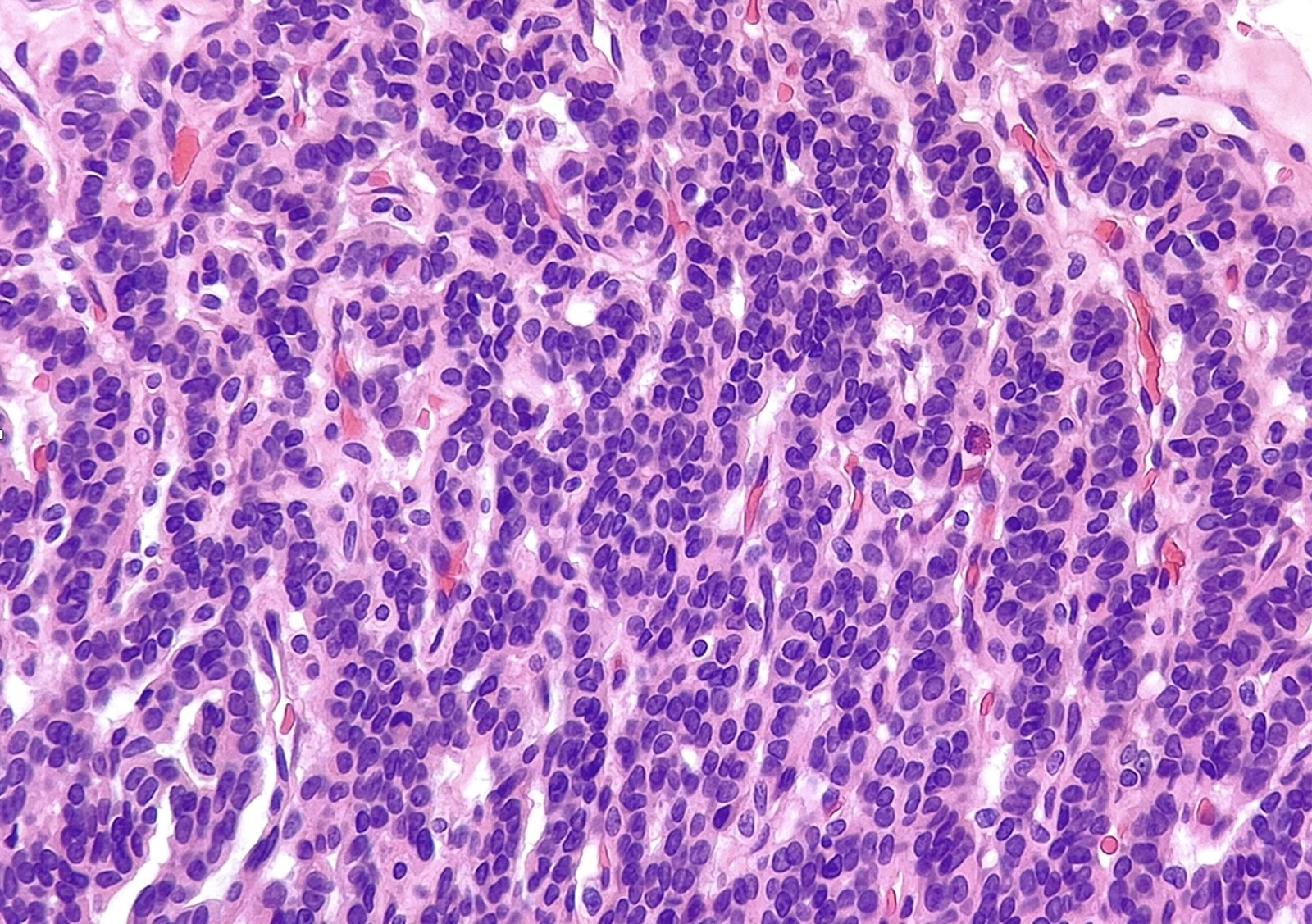 Pathology Outlines - GLI1 altered soft tissue tumors