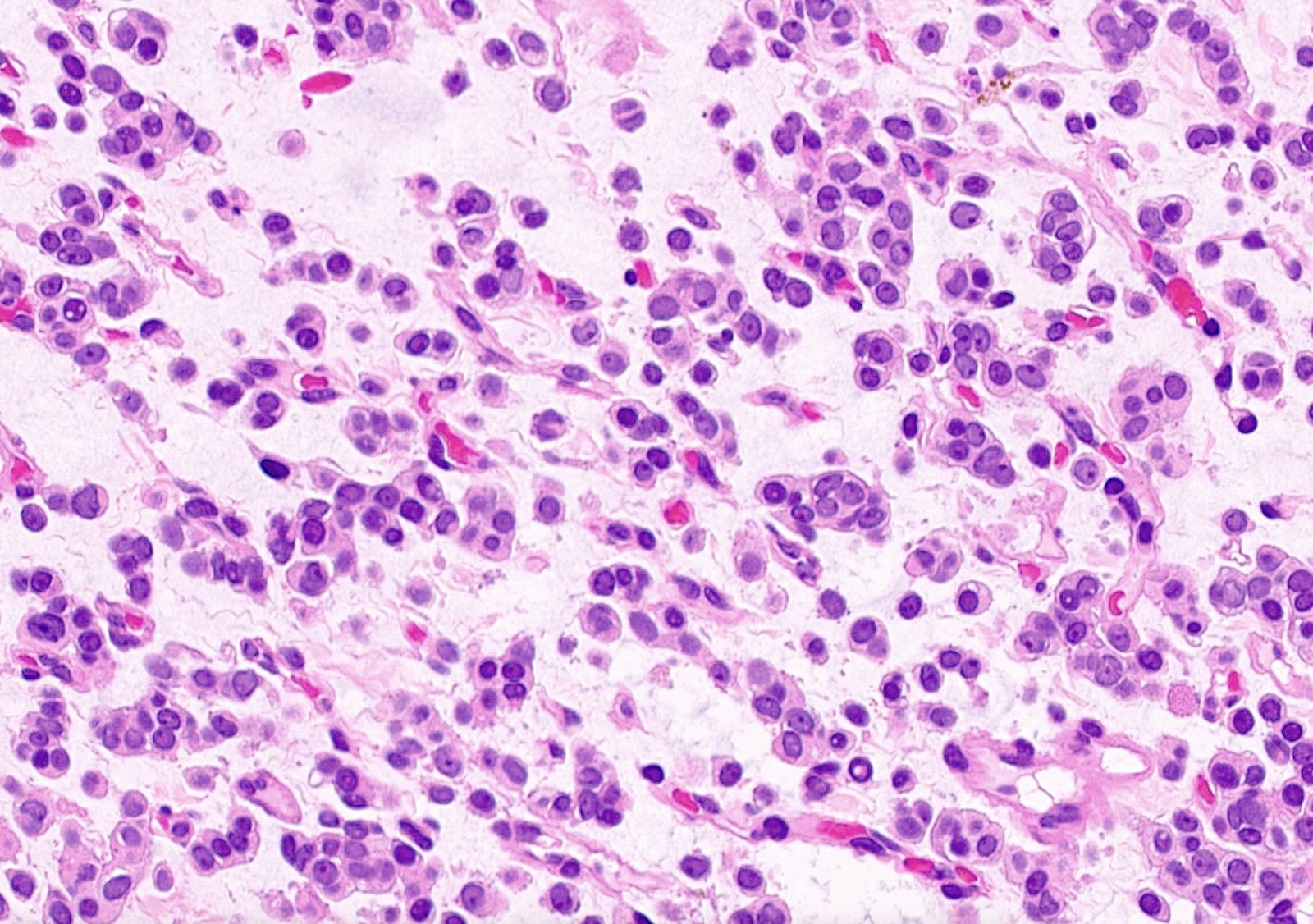 Pathology Outlines - GLI1 altered soft tissue tumors