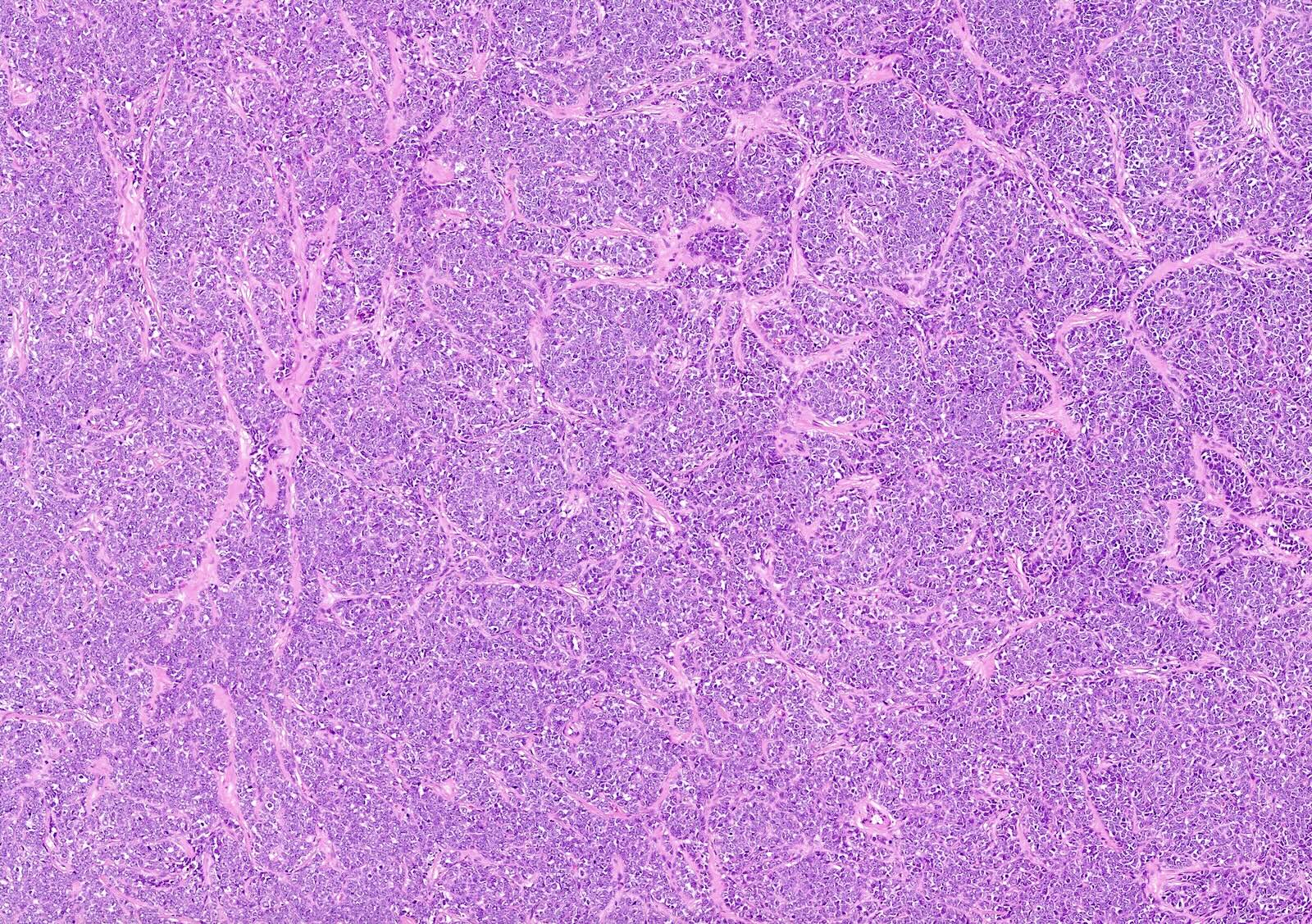 Pathology Outlines - GLI1 altered soft tissue tumors