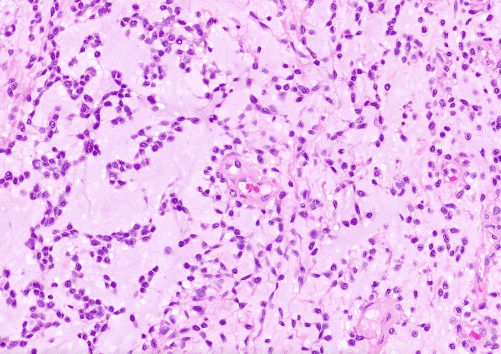 Pathology Outlines - GLI1 altered soft tissue tumors