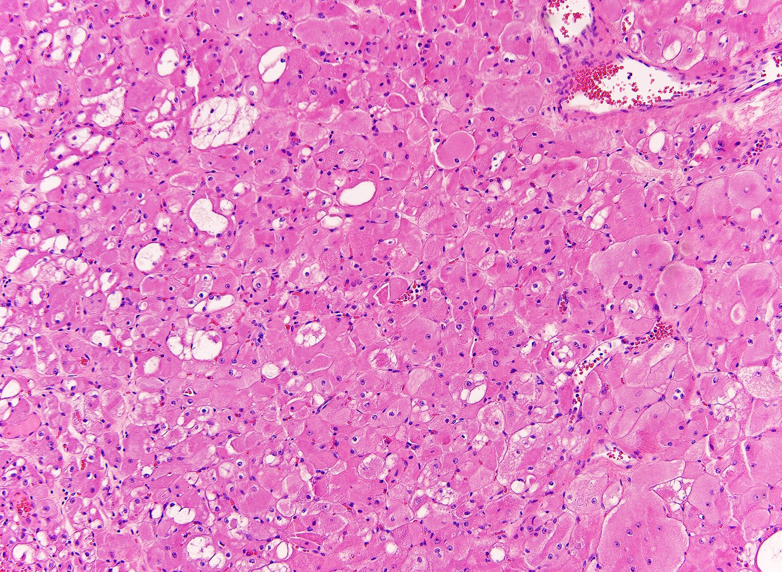 Pathology Outlines - Rhabdomyoma
