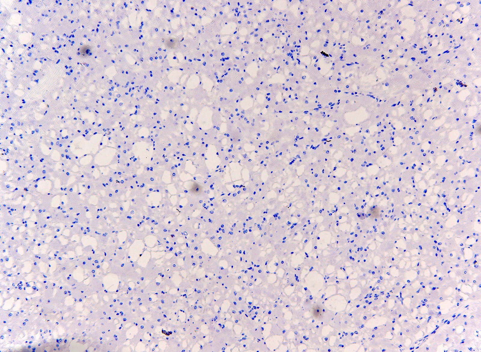 Pathology Outlines - Rhabdomyoma