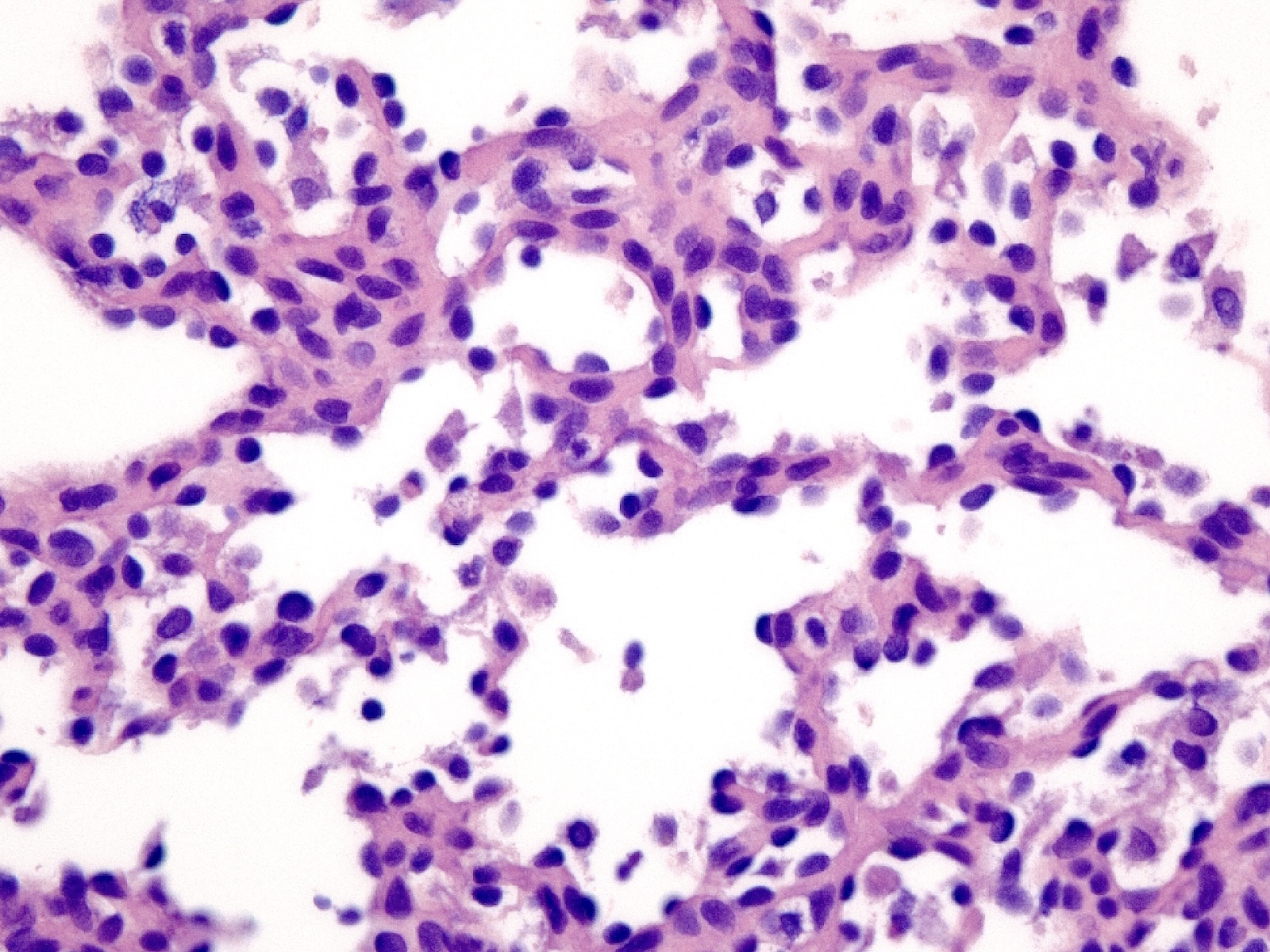 Pathology Outlines - Anastomosing hemangioma