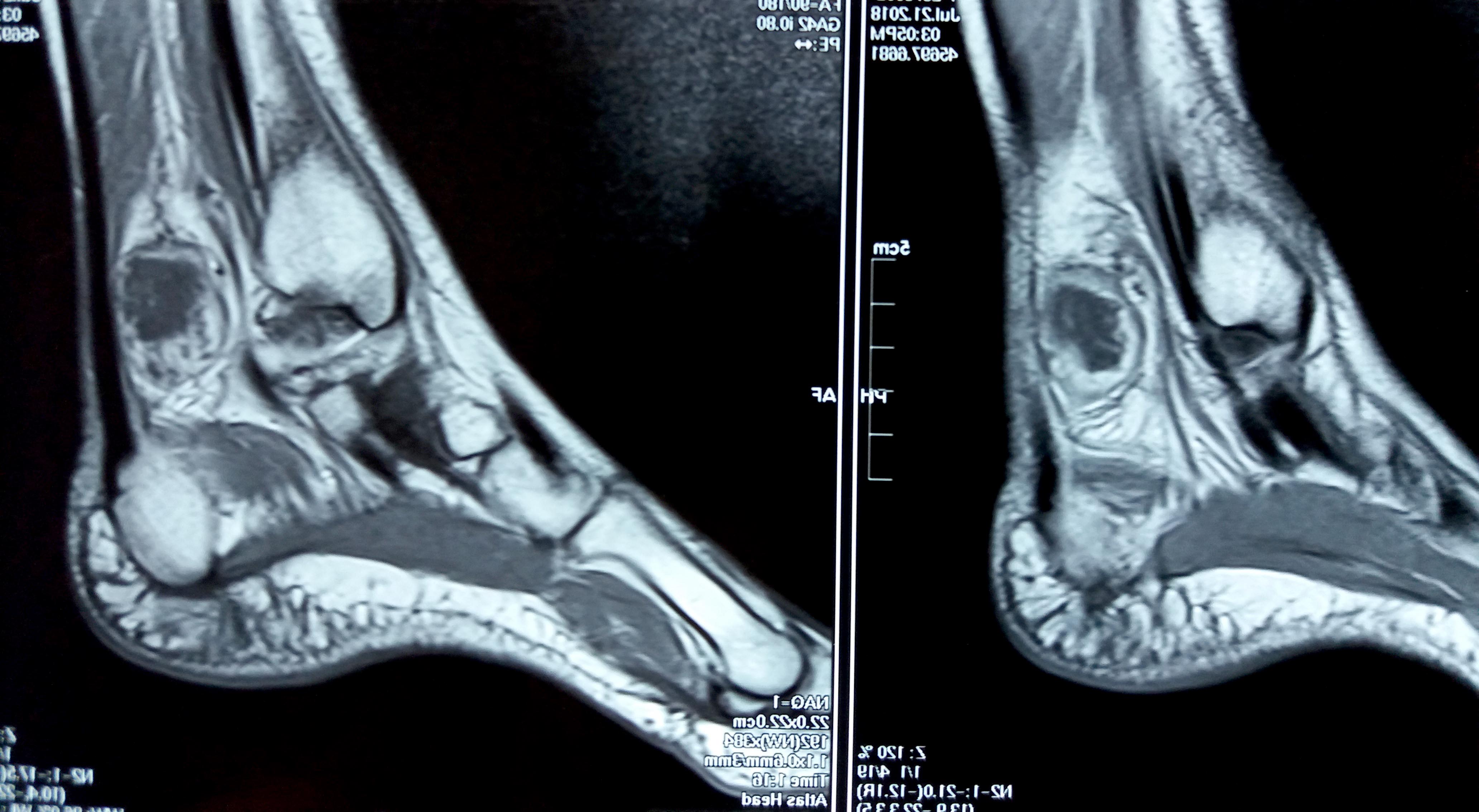 Pathology Outlines - Angiofibroma of soft tissue