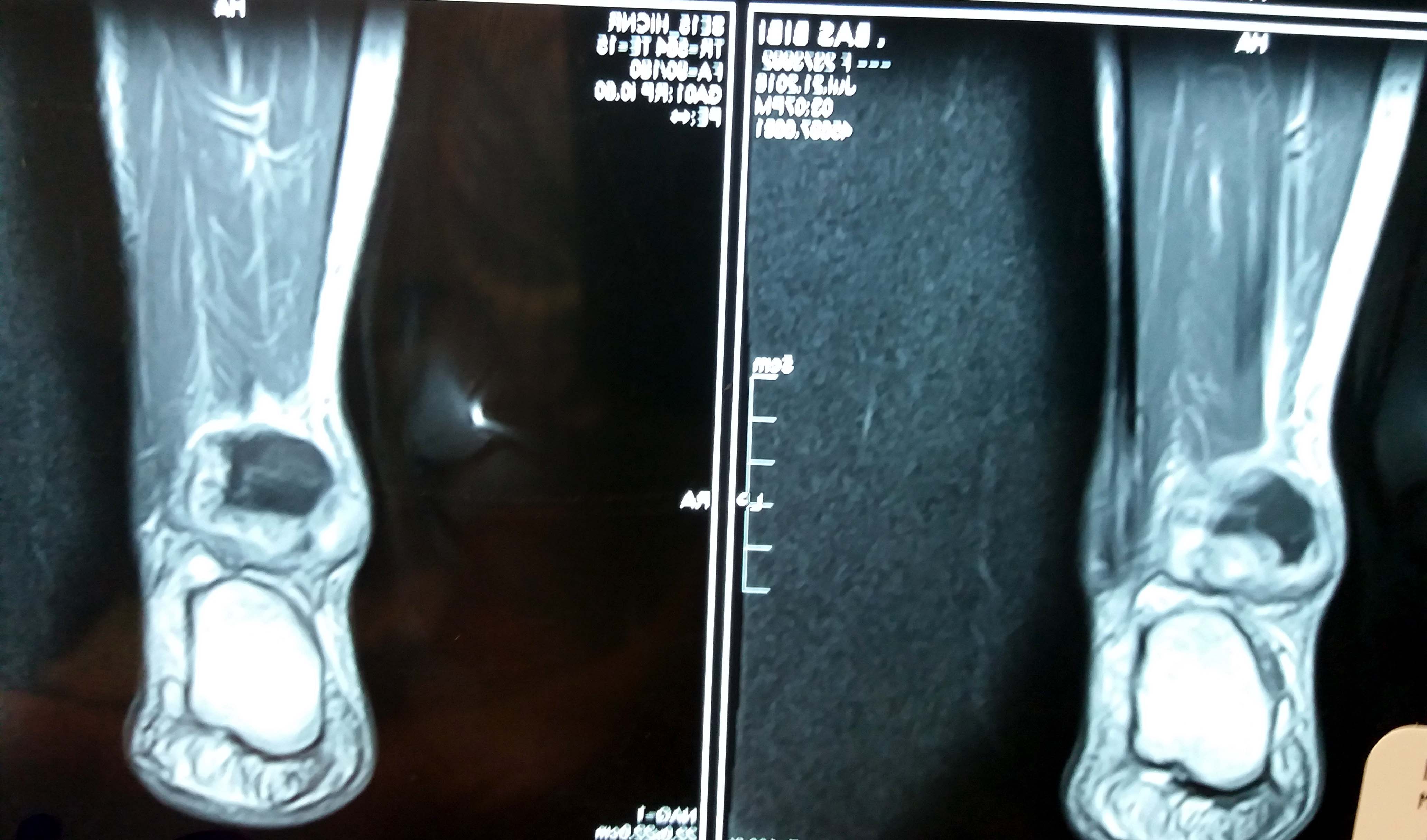 Pathology Outlines - Angiofibroma of soft tissue