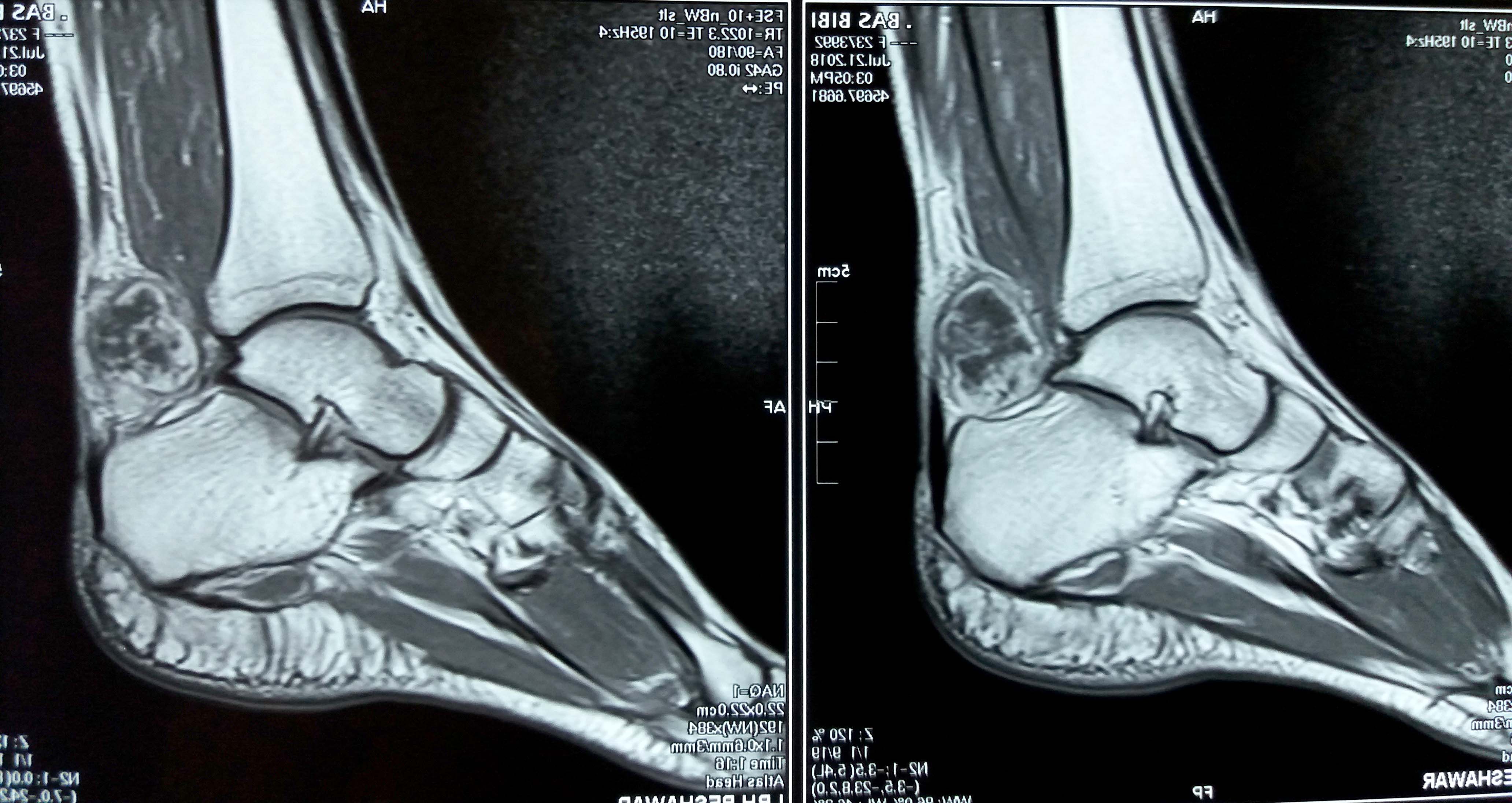 Pathology Outlines - Angiofibroma of soft tissue