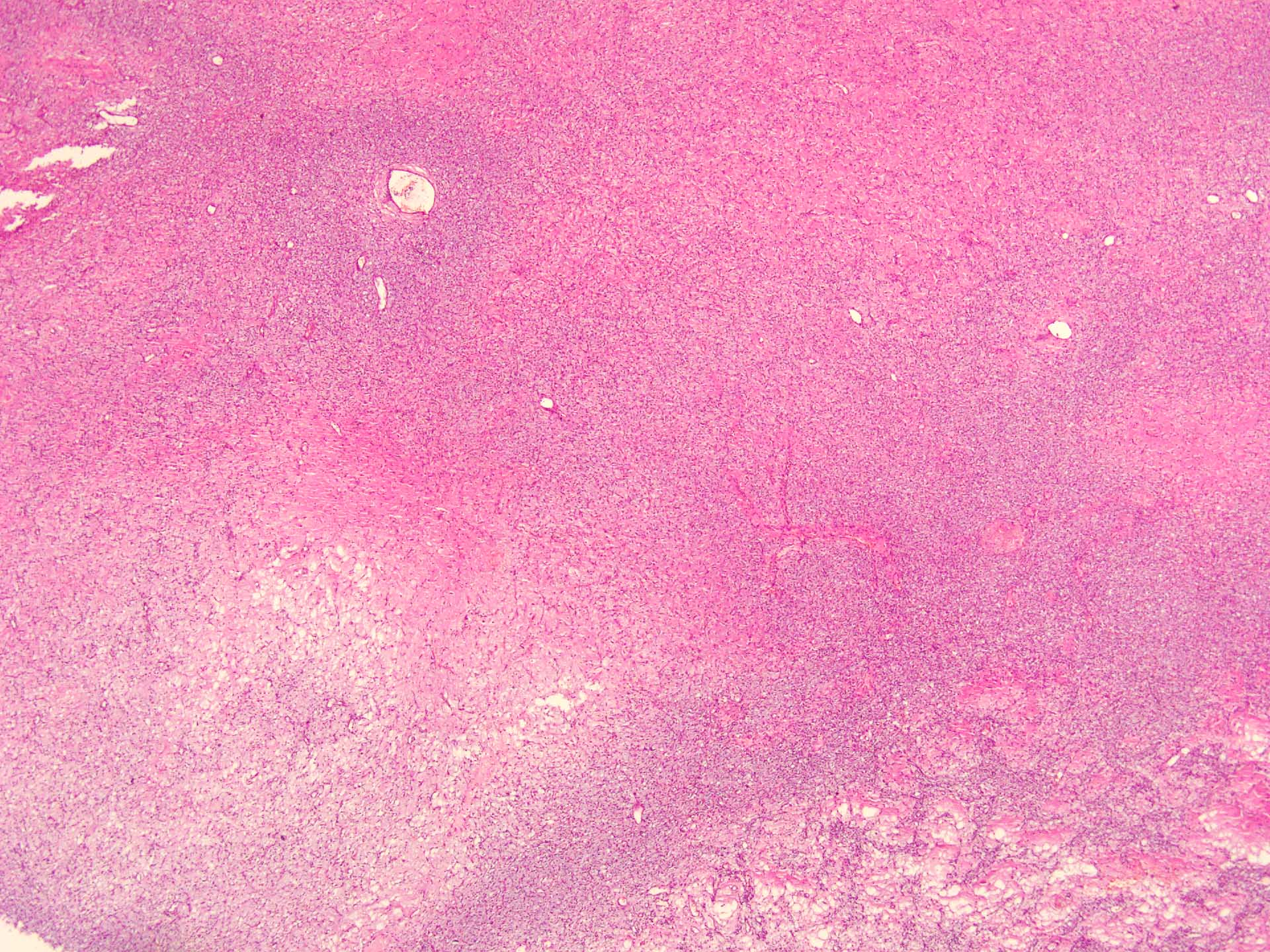 Pathology Outlines - Angiofibroma of soft tissue