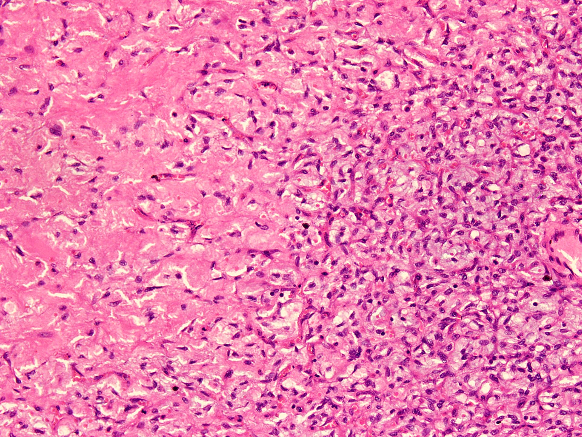 Pathology Outlines - Angiofibroma of soft tissue