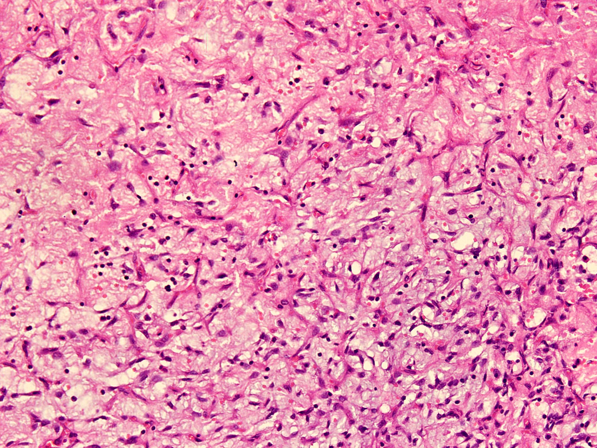 Pathology Outlines - Angiofibroma of soft tissue