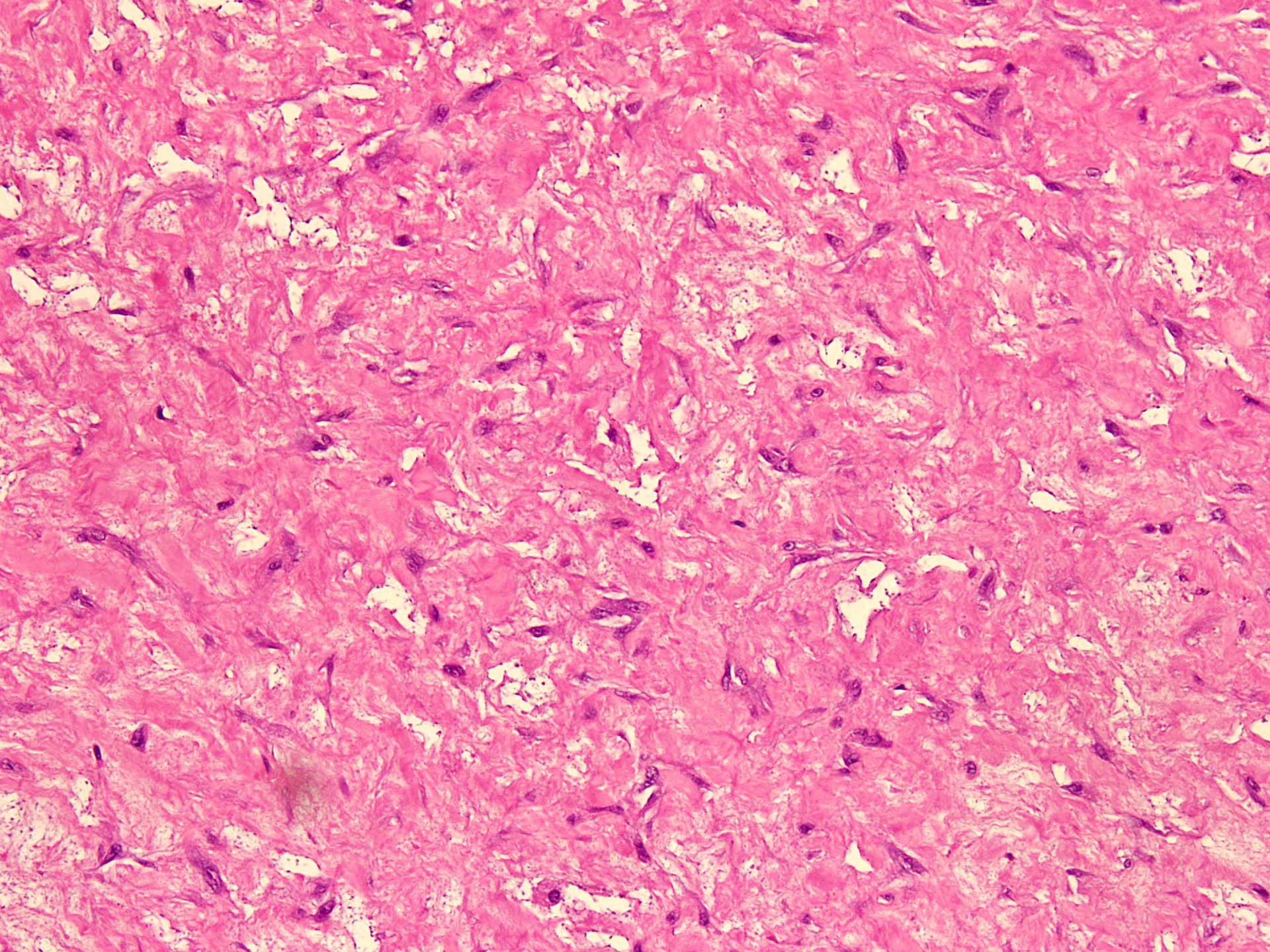 Pathology Outlines - Angiofibroma of soft tissue