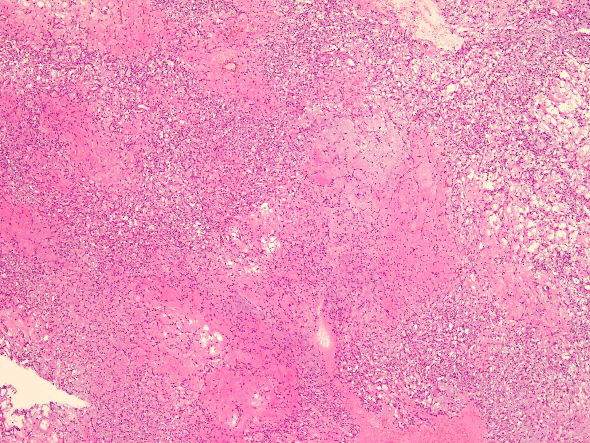 Pathology Outlines - Angiofibroma of soft tissue