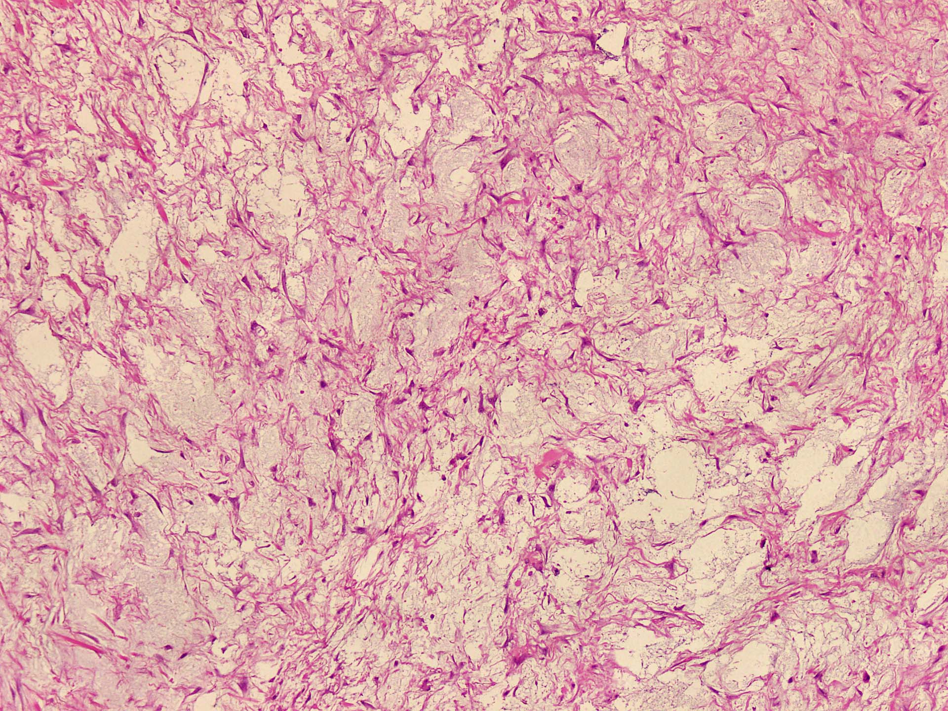 Histologia Do Angiofibroma