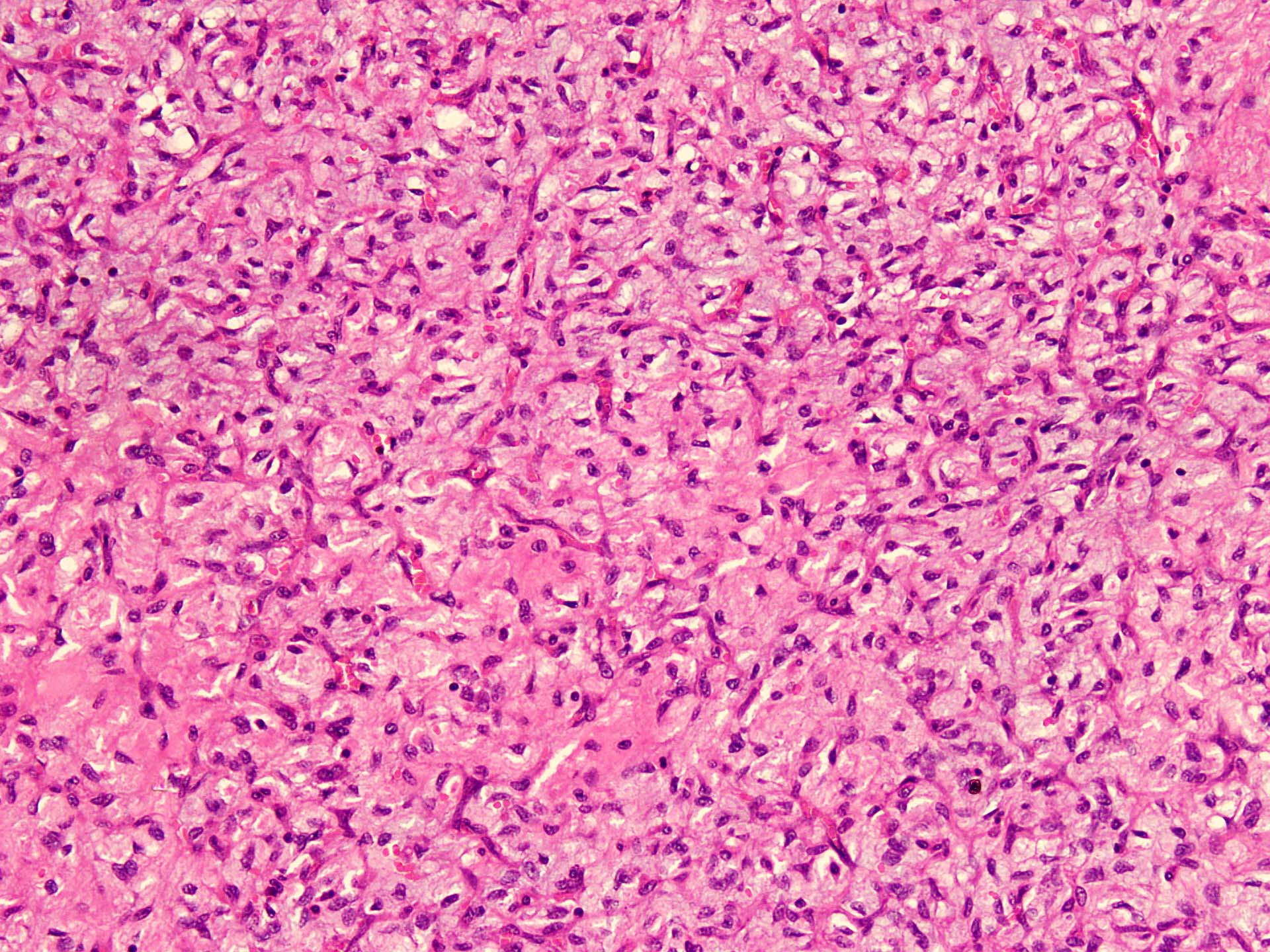 Histologia Do Angiofibroma JUVENILE ANGIOFIBROMA: HISTOLOGY AND