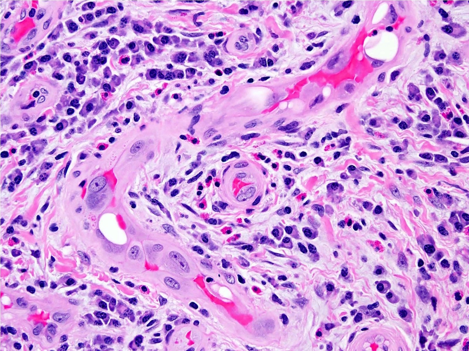 Pathology Outlines - Epithelioid hemangioma