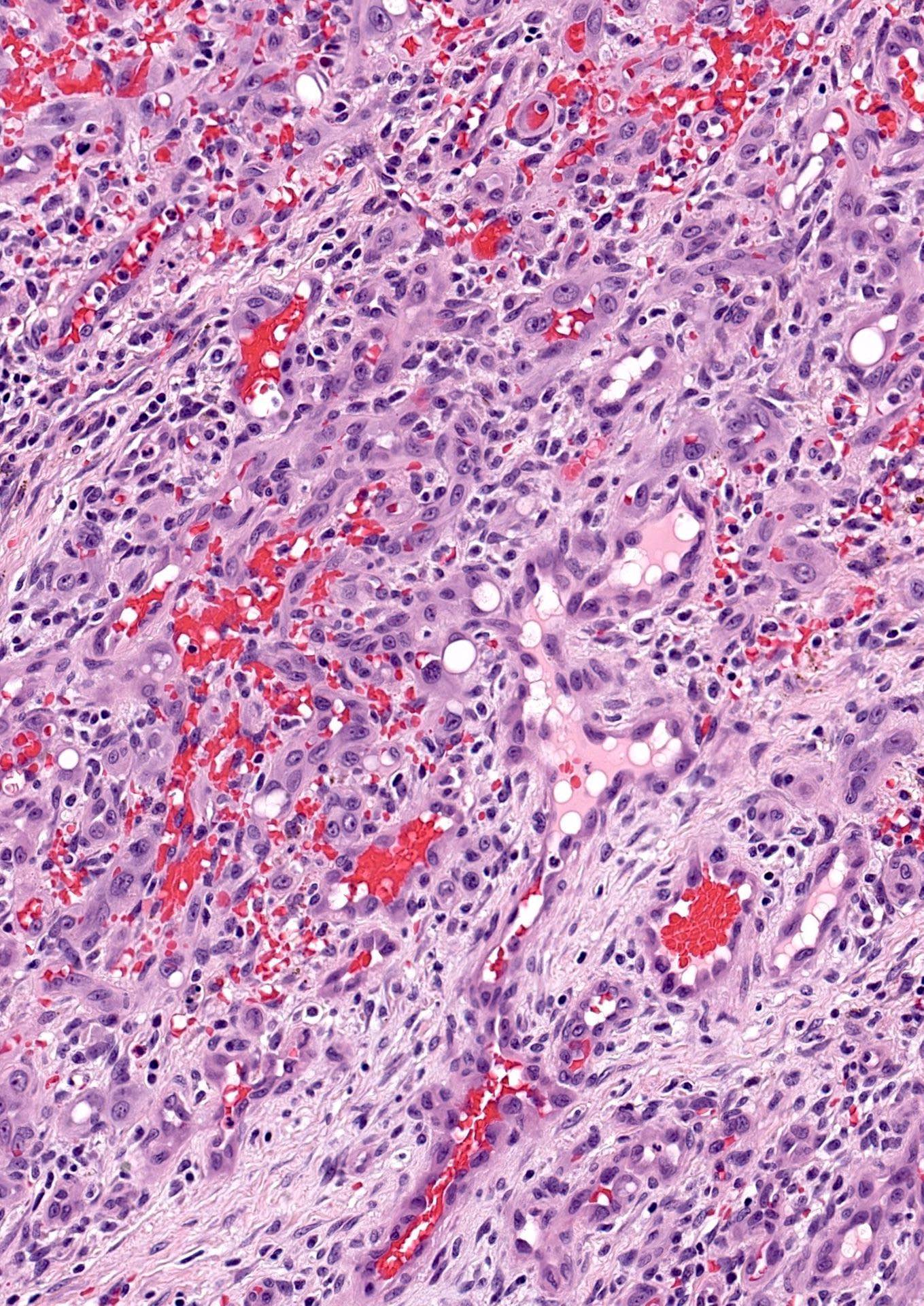 Pathology Outlines - Epithelioid hemangioma