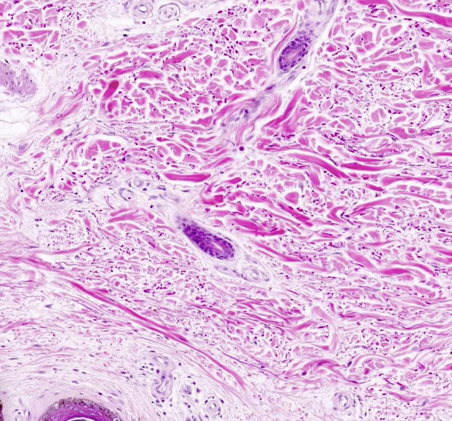 Pathology Outlines - Histology-fibrous tissue & nerve