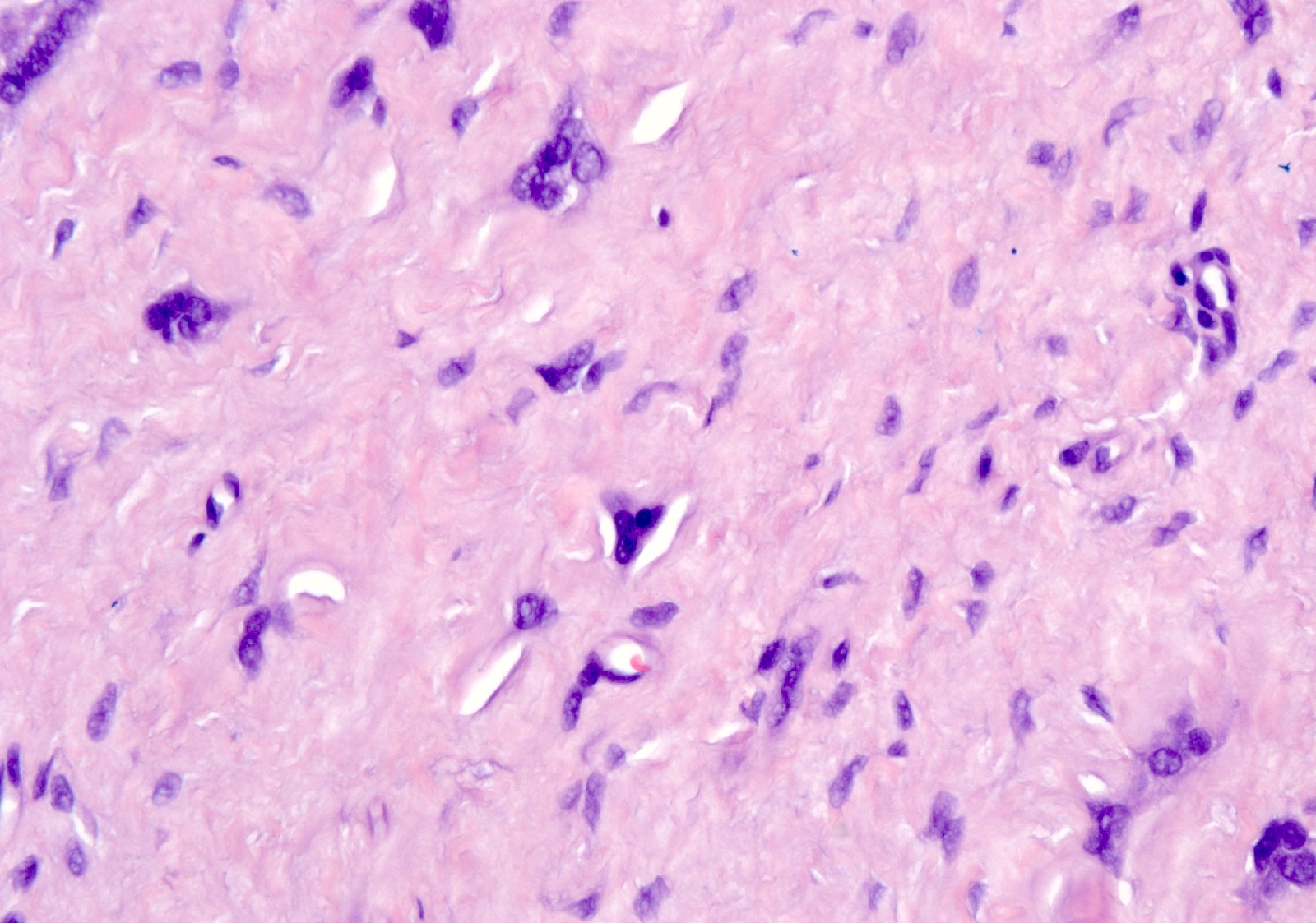 Pathology Outlines - Giant cell fibroblastoma