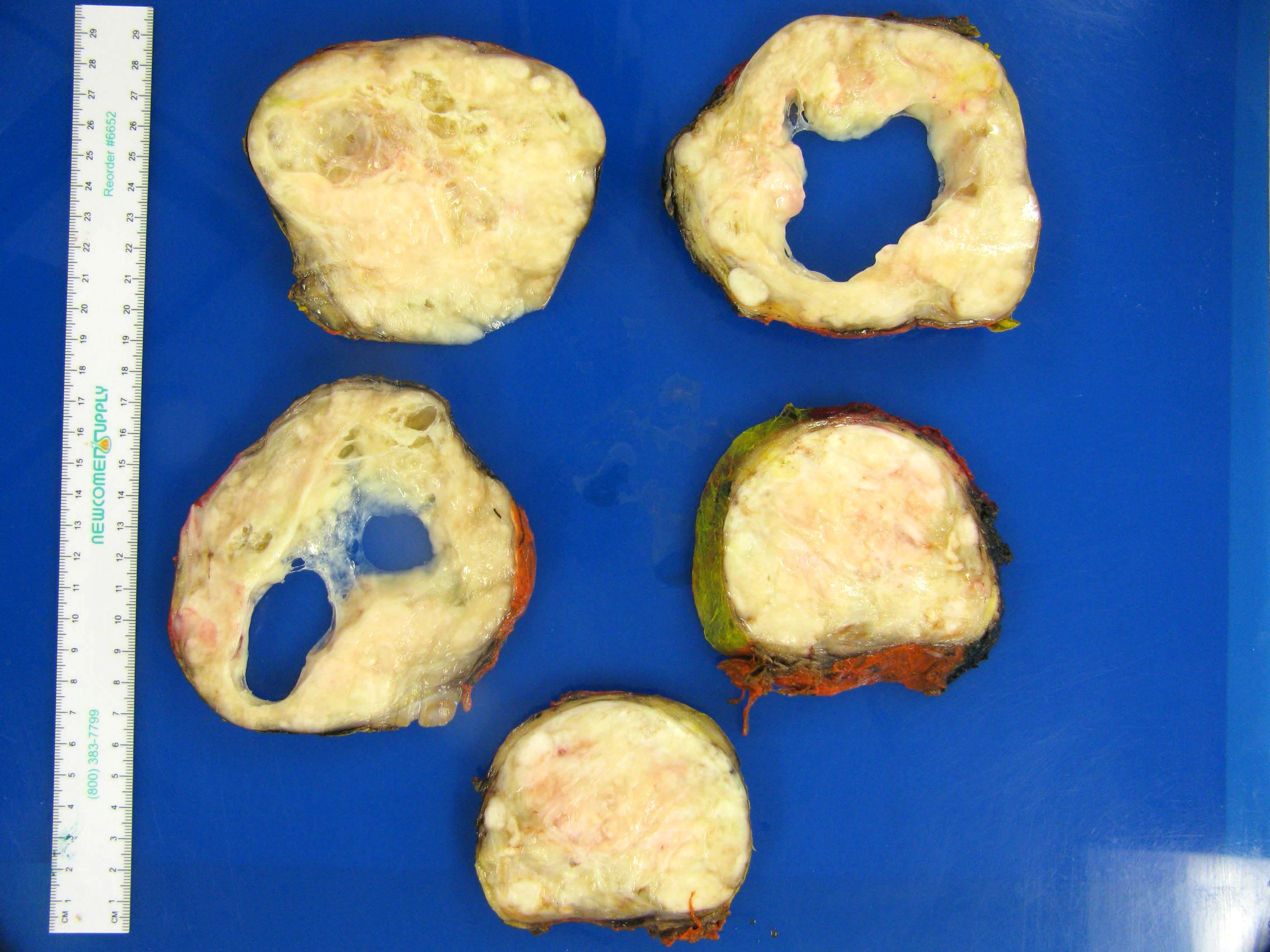 Pathology Outlines - Low grade myofibroblastic sarcoma
