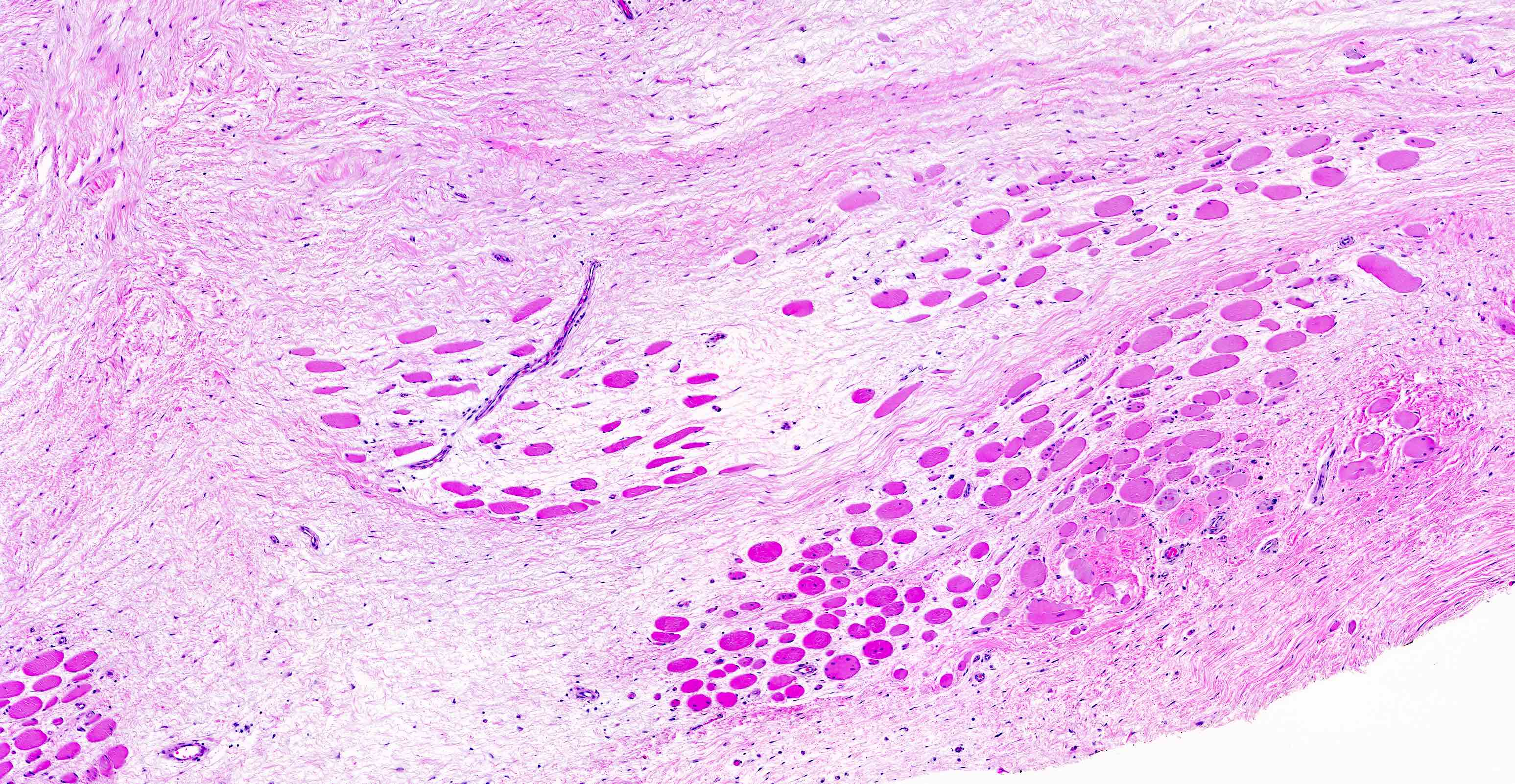 Pathology Outlines - Intramuscular myxoma