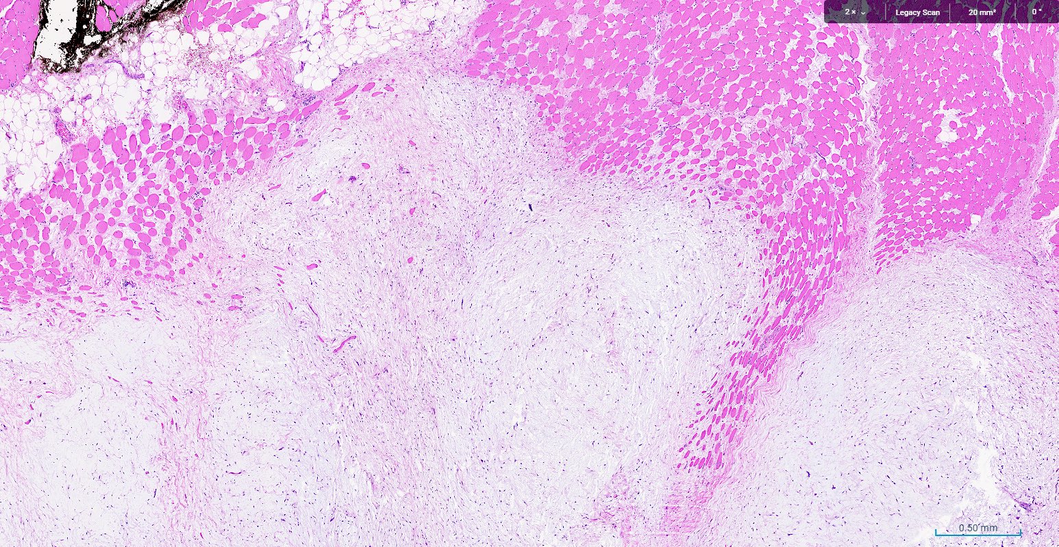 Pathology Outlines - Intramuscular myxoma