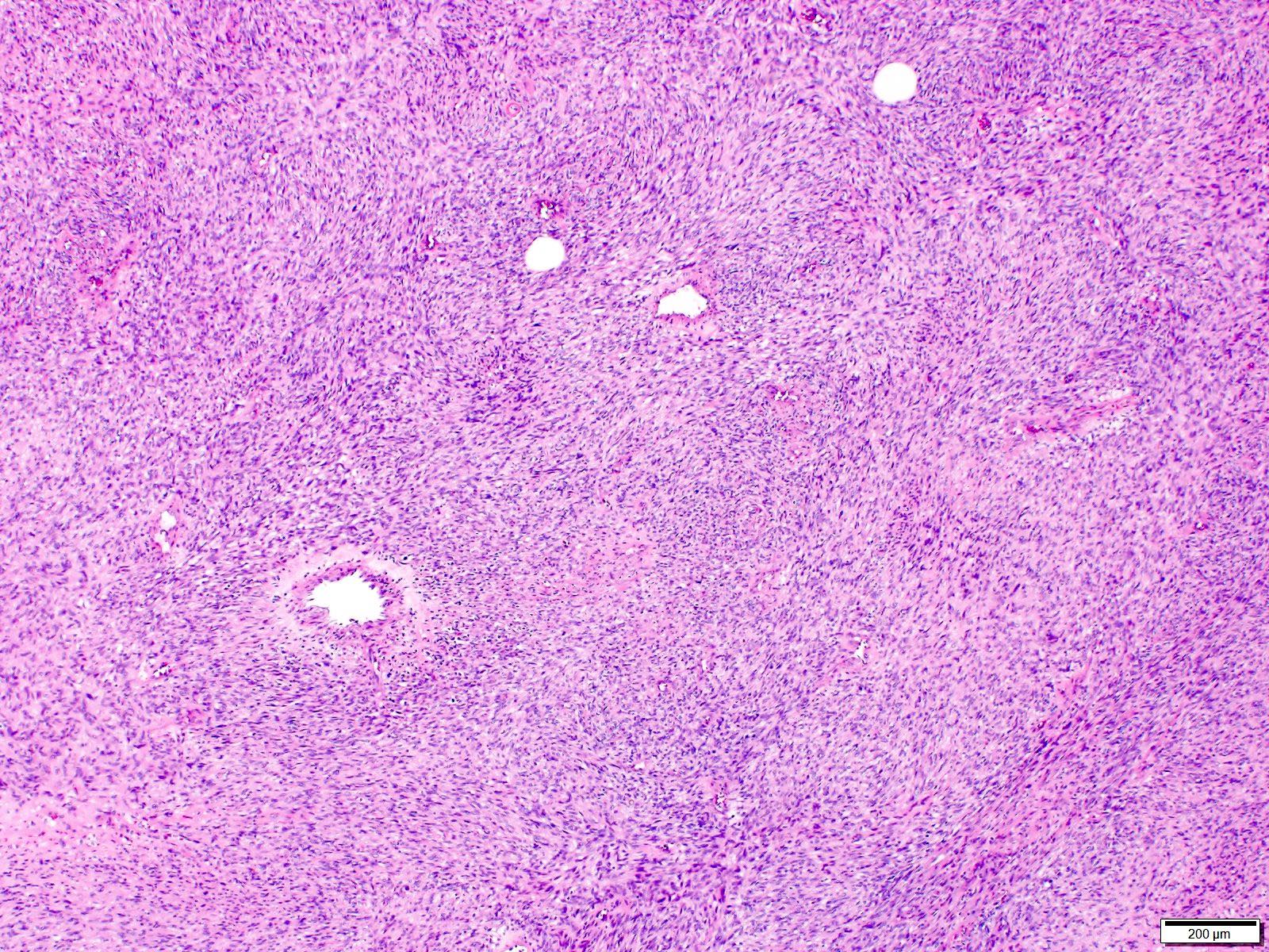 Pathology Outlines - NTRK rearranged spindle cell neoplasm