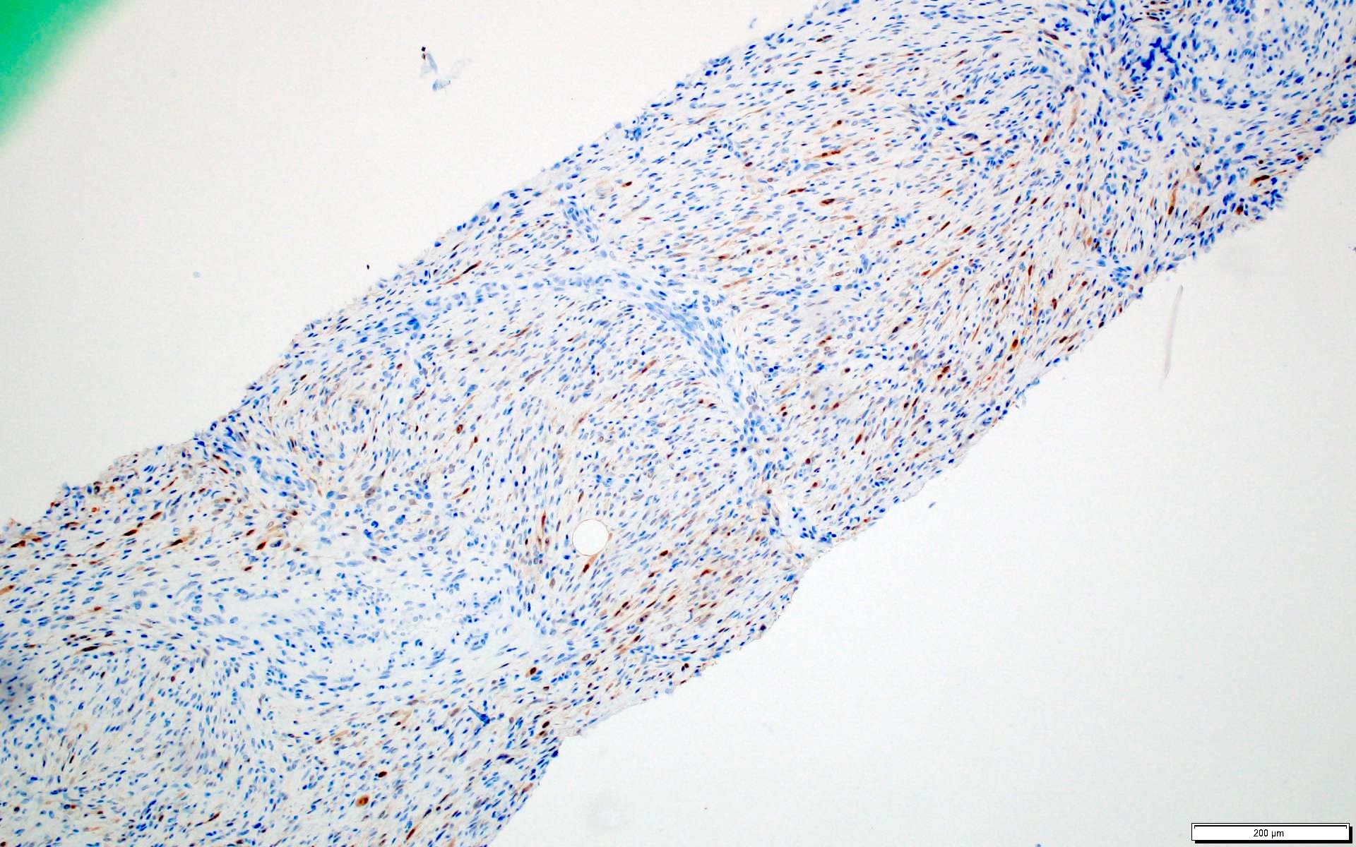 Pathology Outlines - NTRK rearranged spindle cell neoplasm