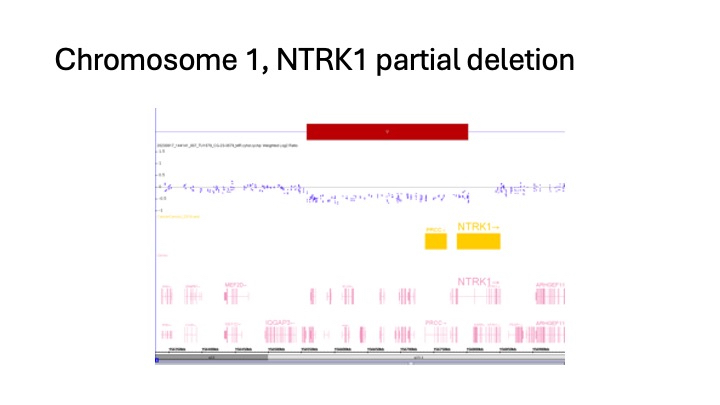 Pathology Outlines - NTRK rearranged spindle cell neoplasm
