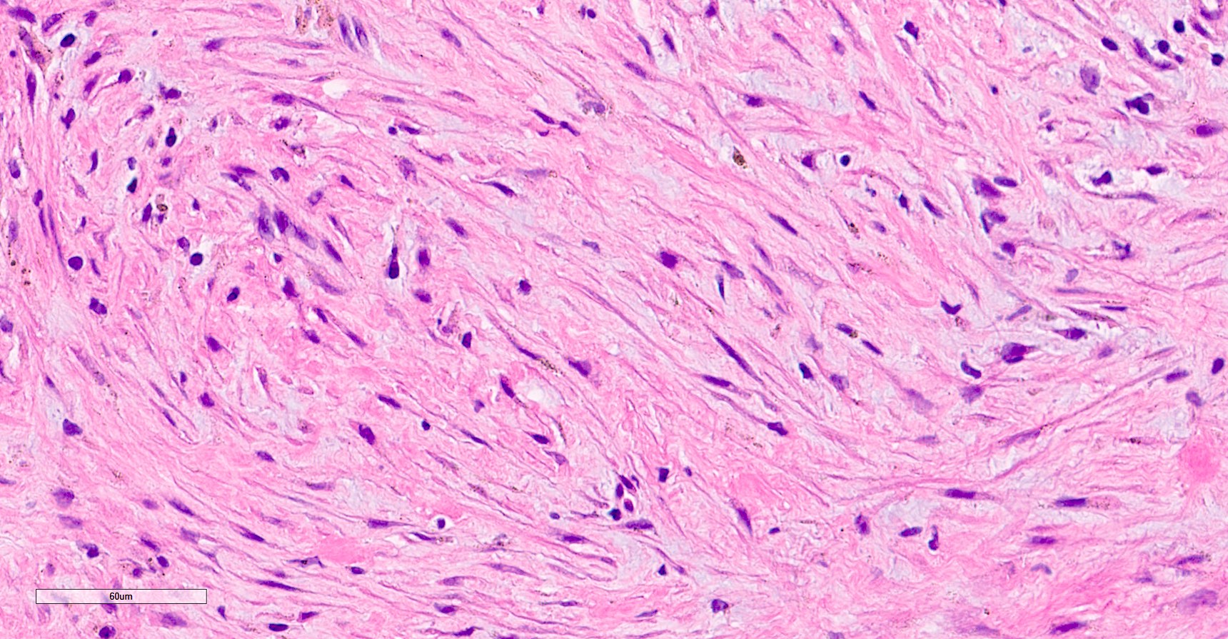 Pathology Outlines - Pseudotumor / funiculitis