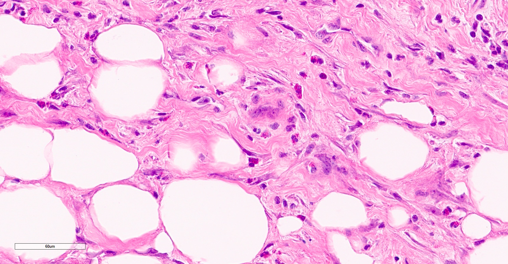 Pathology Outlines - Pseudotumor / funiculitis