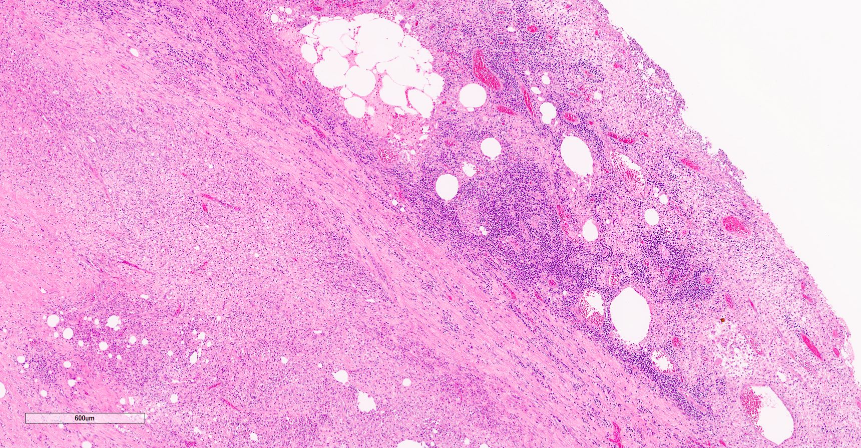 Pathology Outlines - Pseudotumor / funiculitis