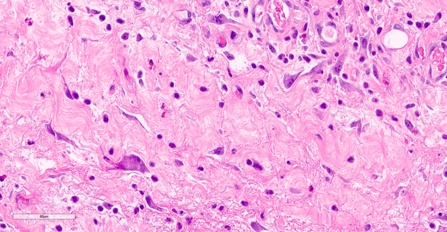 Pathology Outlines - Pseudotumor / funiculitis