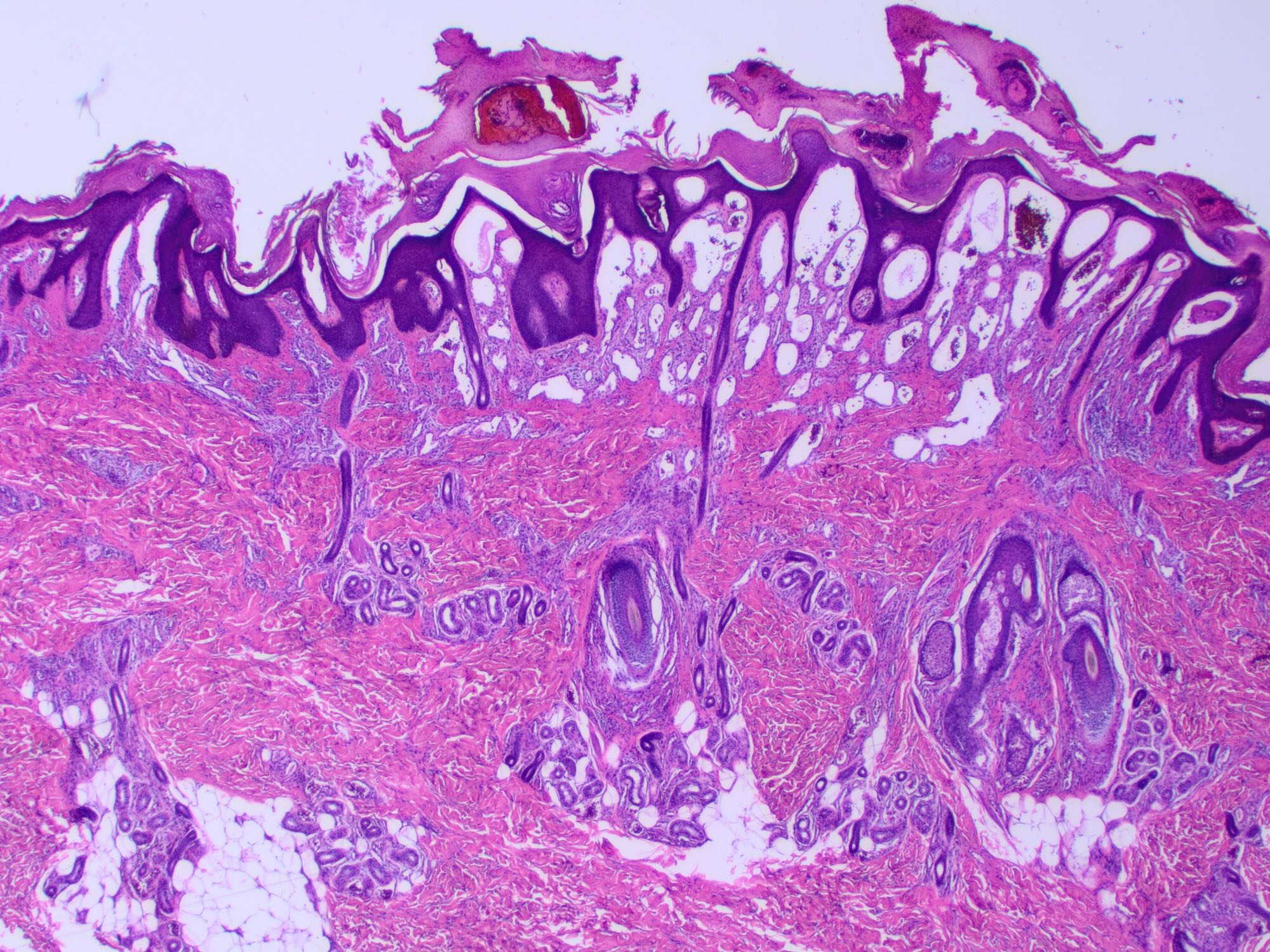 Pathology Outlines - Verrucous venous malformation