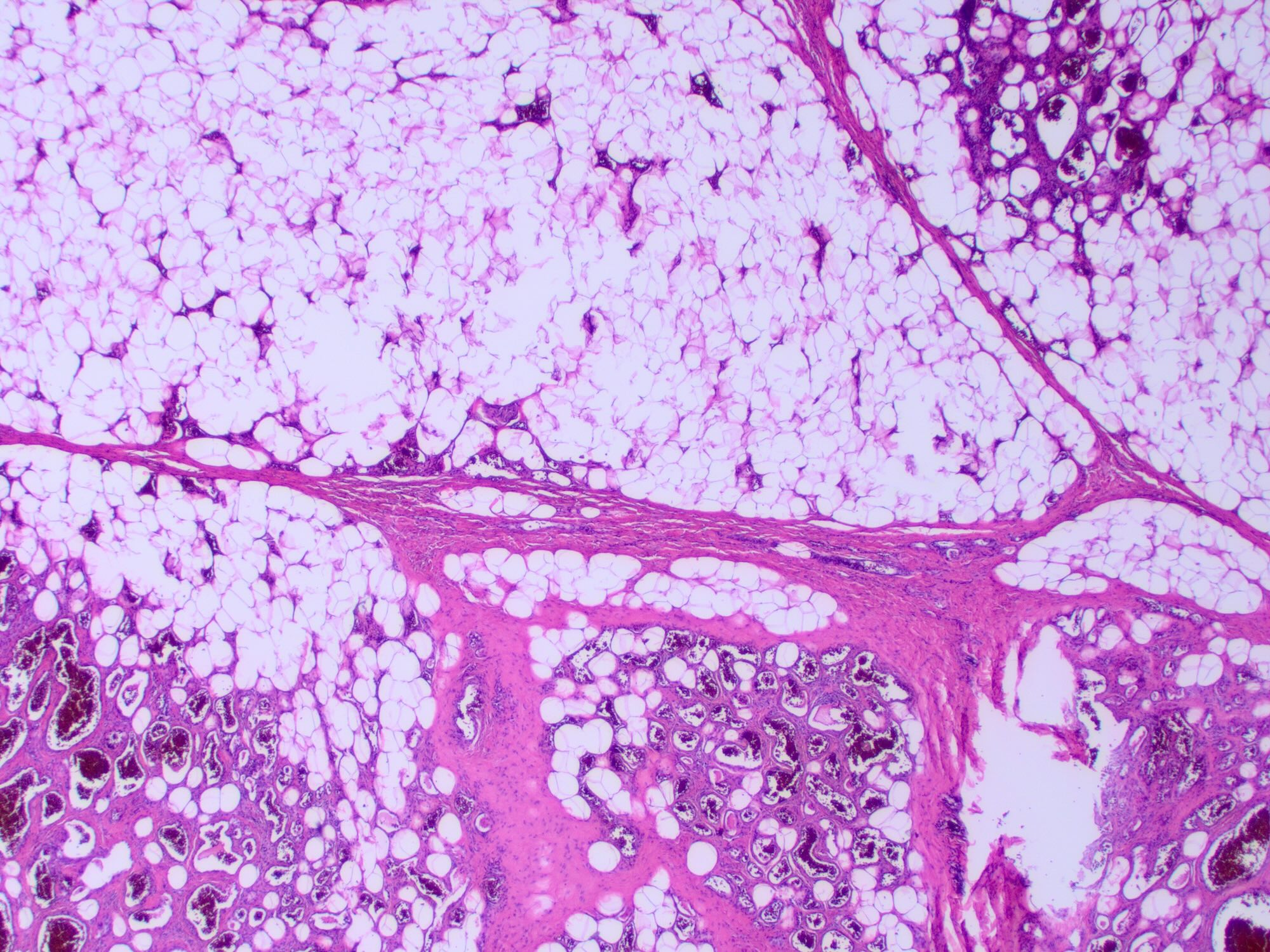 Pathology Outlines - Verrucous venous malformation