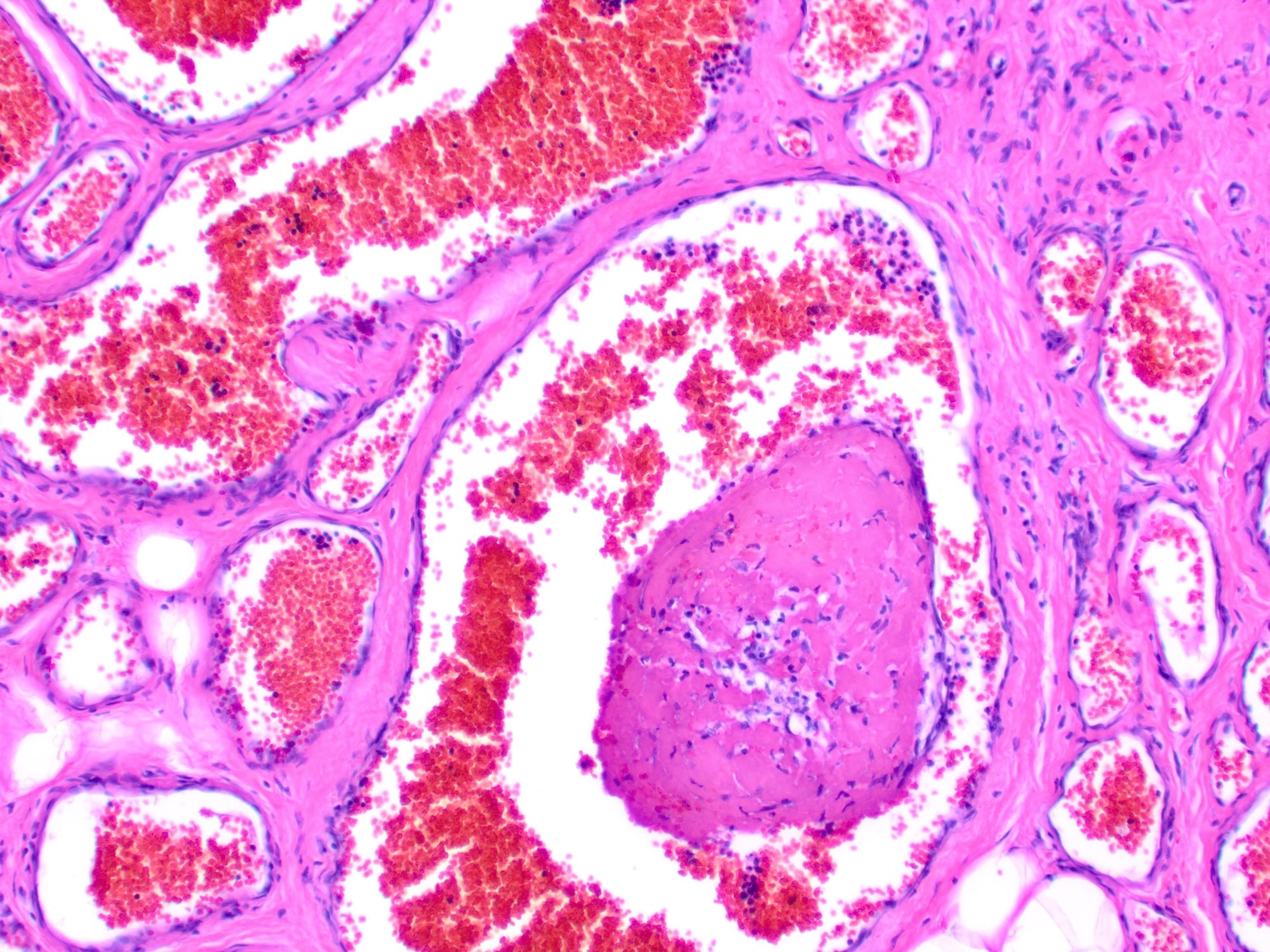 Pathology Outlines - Verrucous venous malformation