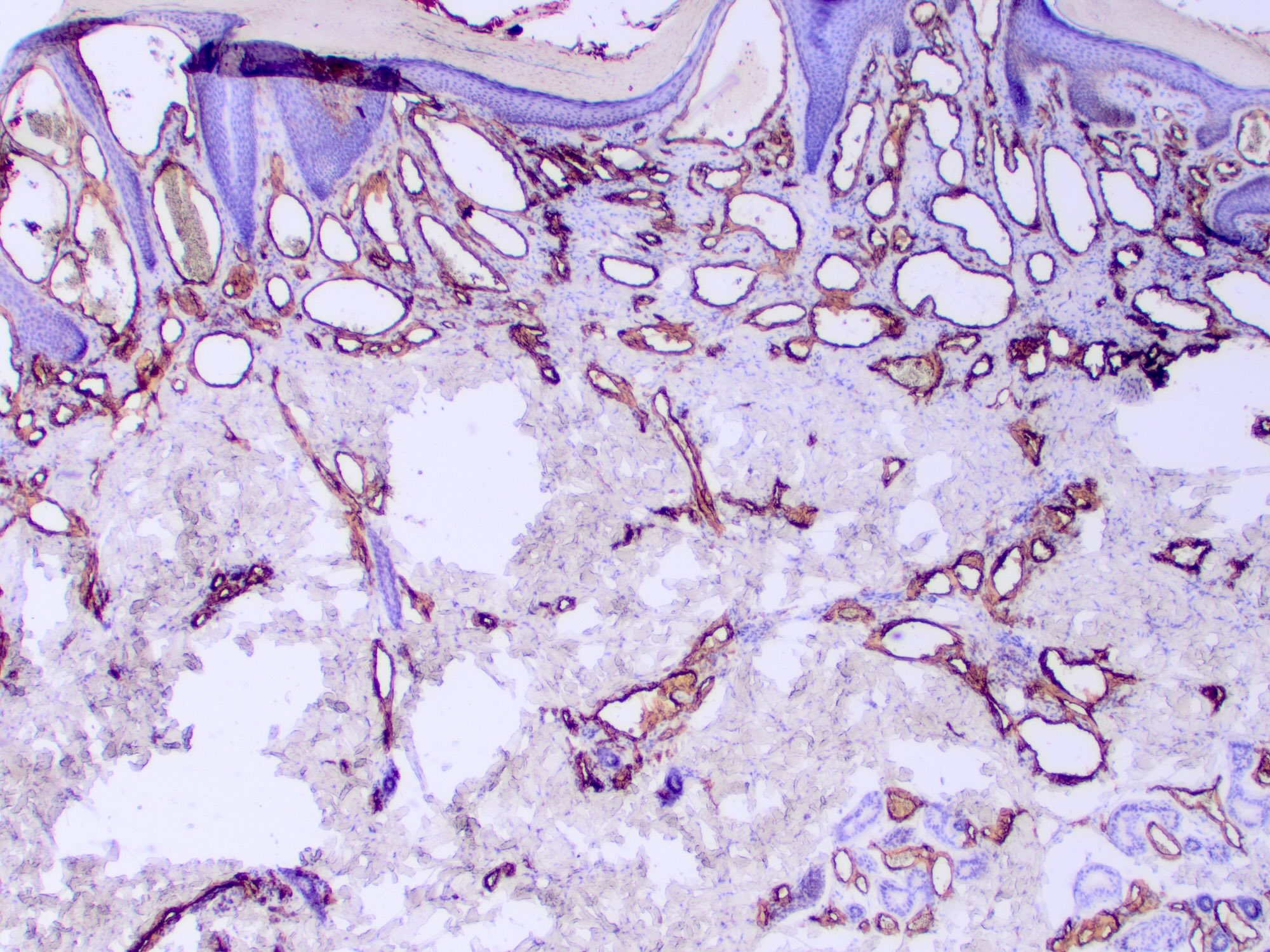 Pathology Outlines - Verrucous venous malformation