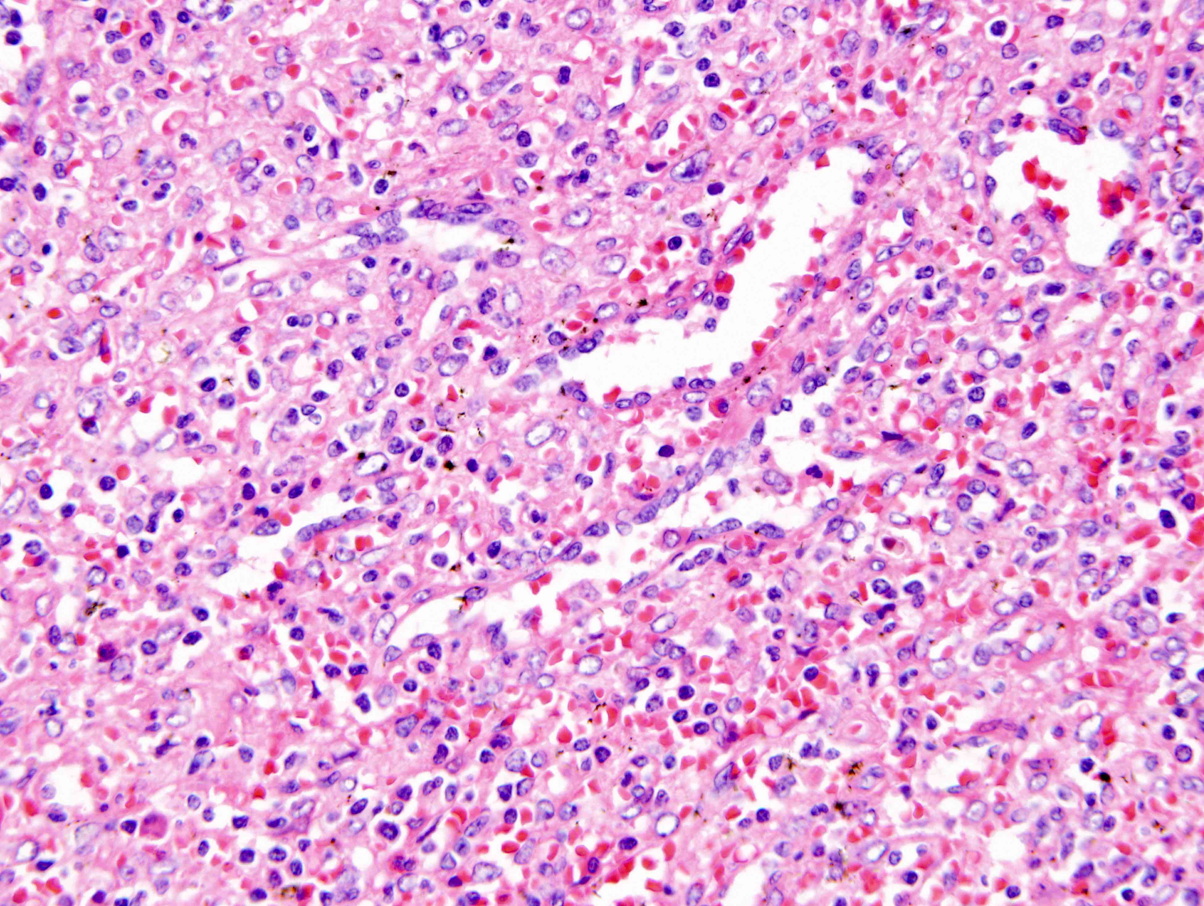 Pathology Outlines - Hamartoma