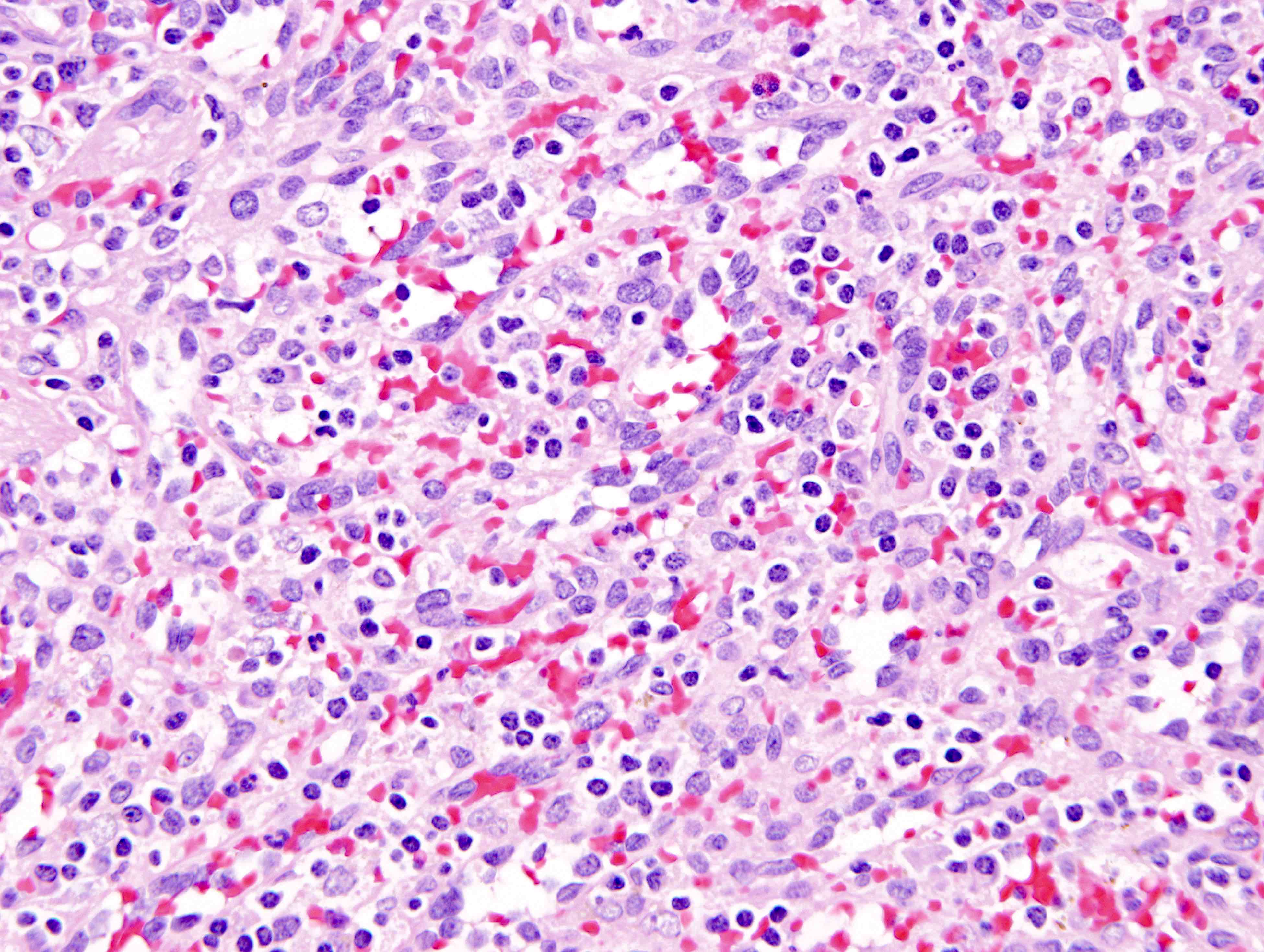 Pathology Outlines - Hamartoma