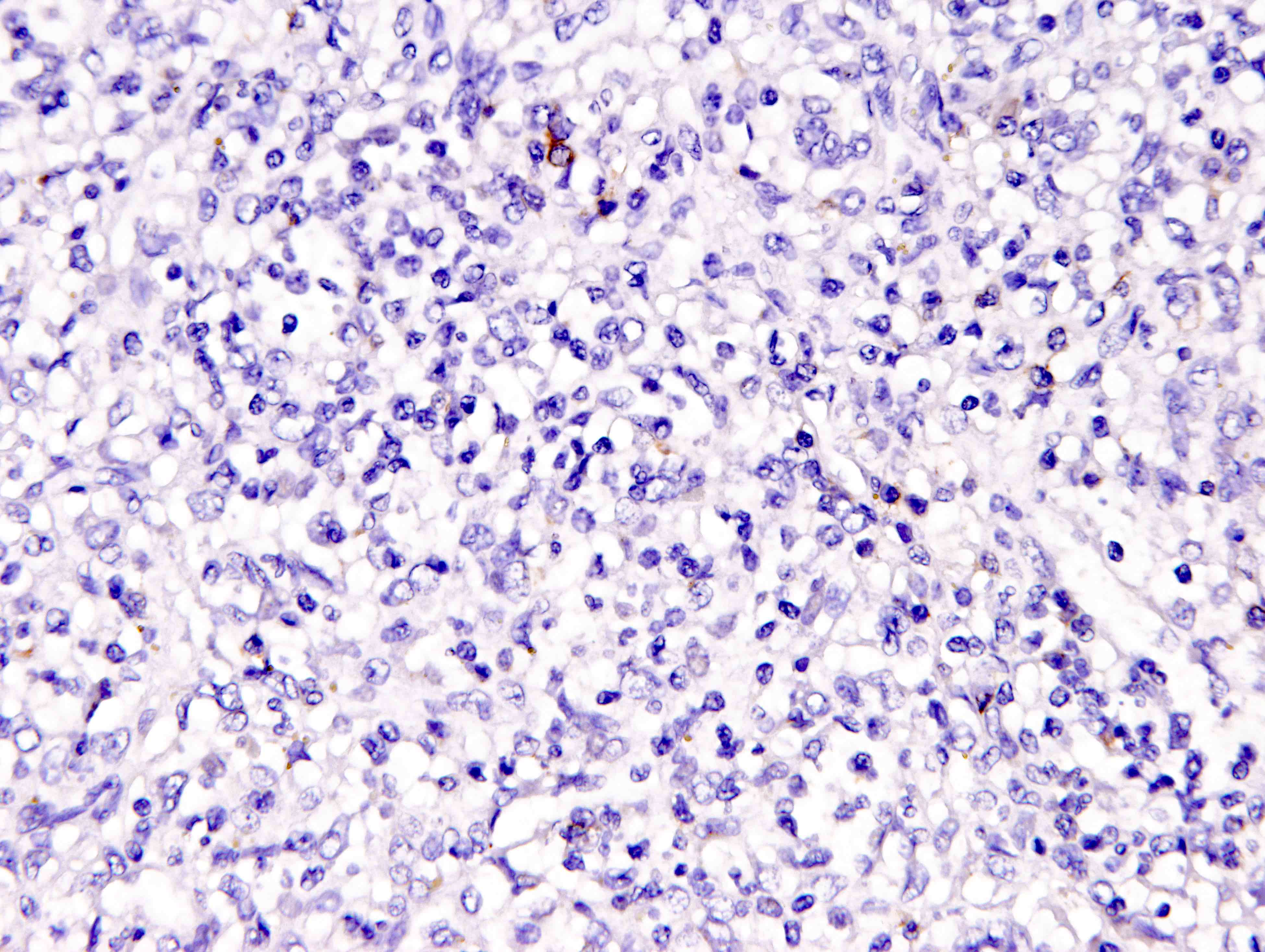 Pathology Outlines - Hamartoma