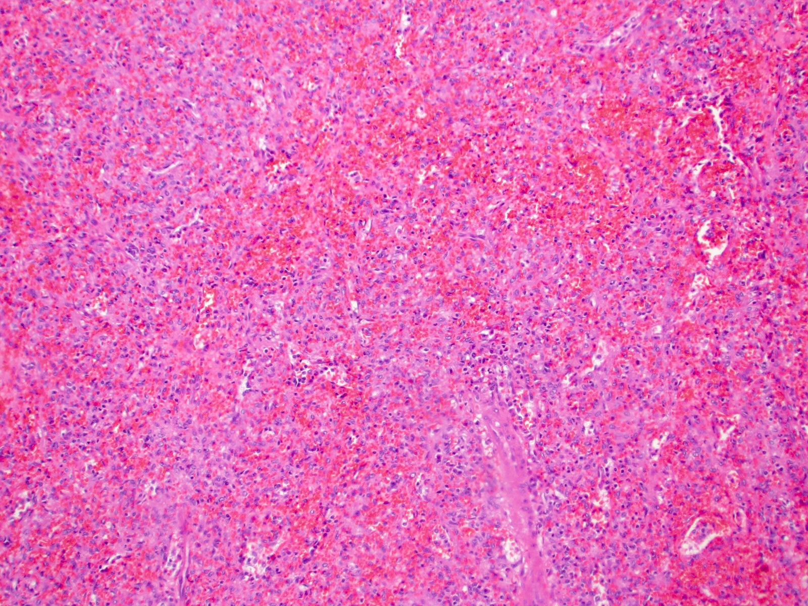 Pathology Outlines - Hemangioma-spleen