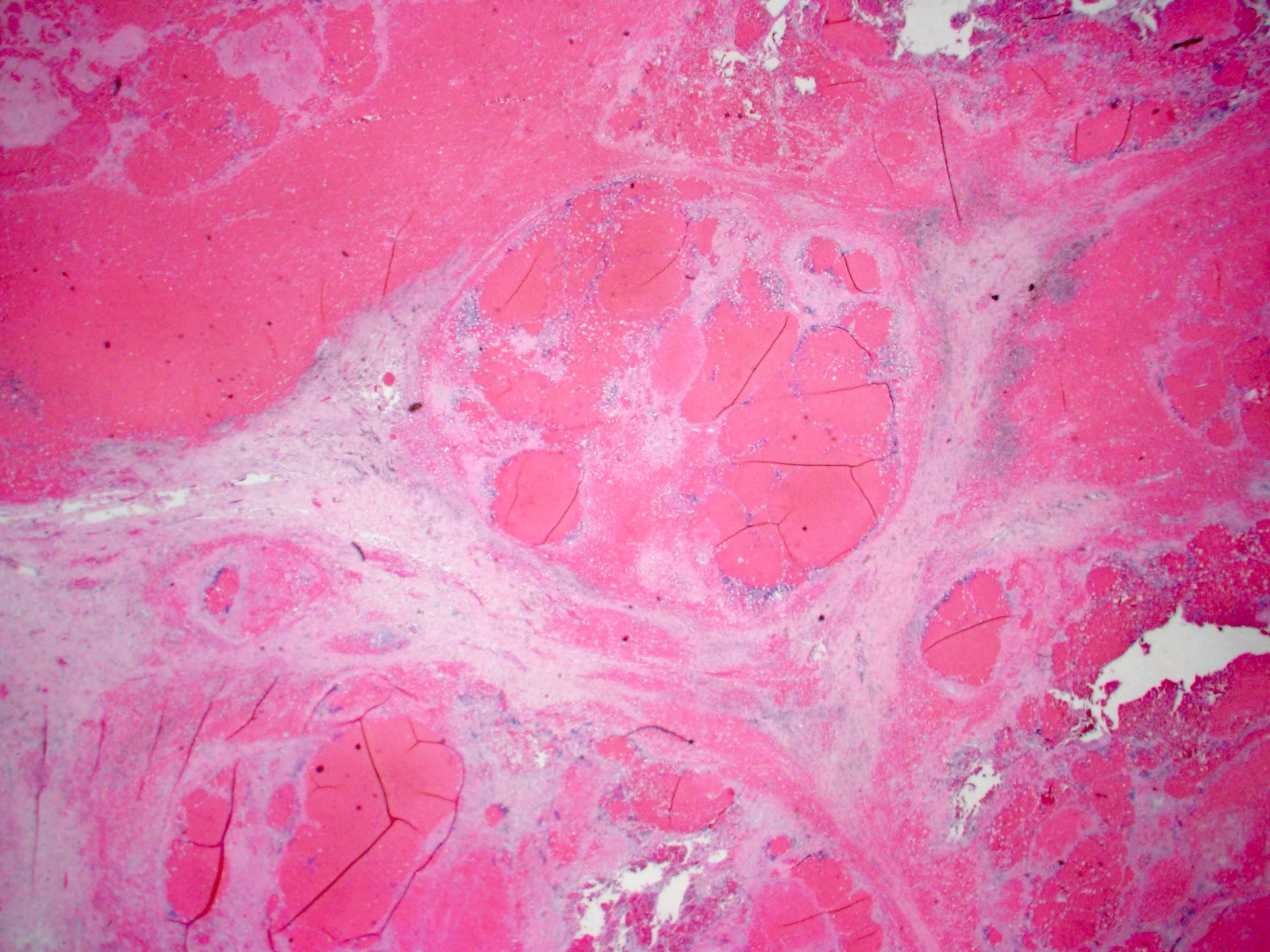 Pathology Outlines - Hemangioma-spleen