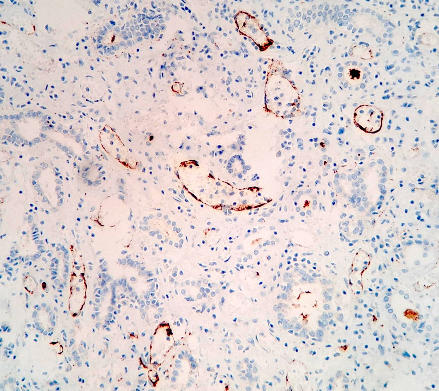 Pathology Outlines - C4d