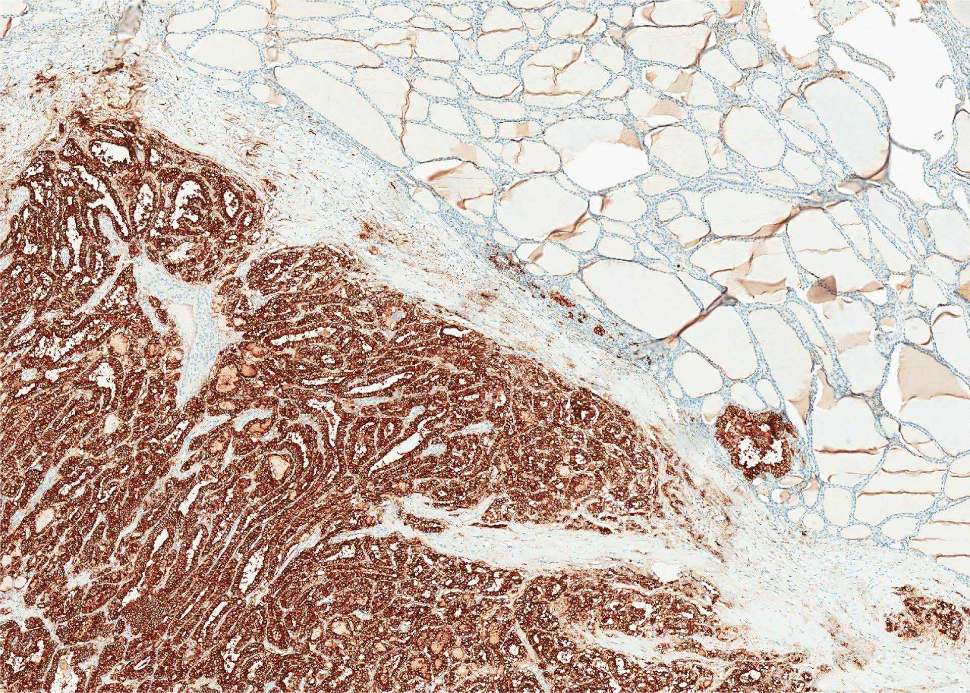 Pathology Outlines - HBME