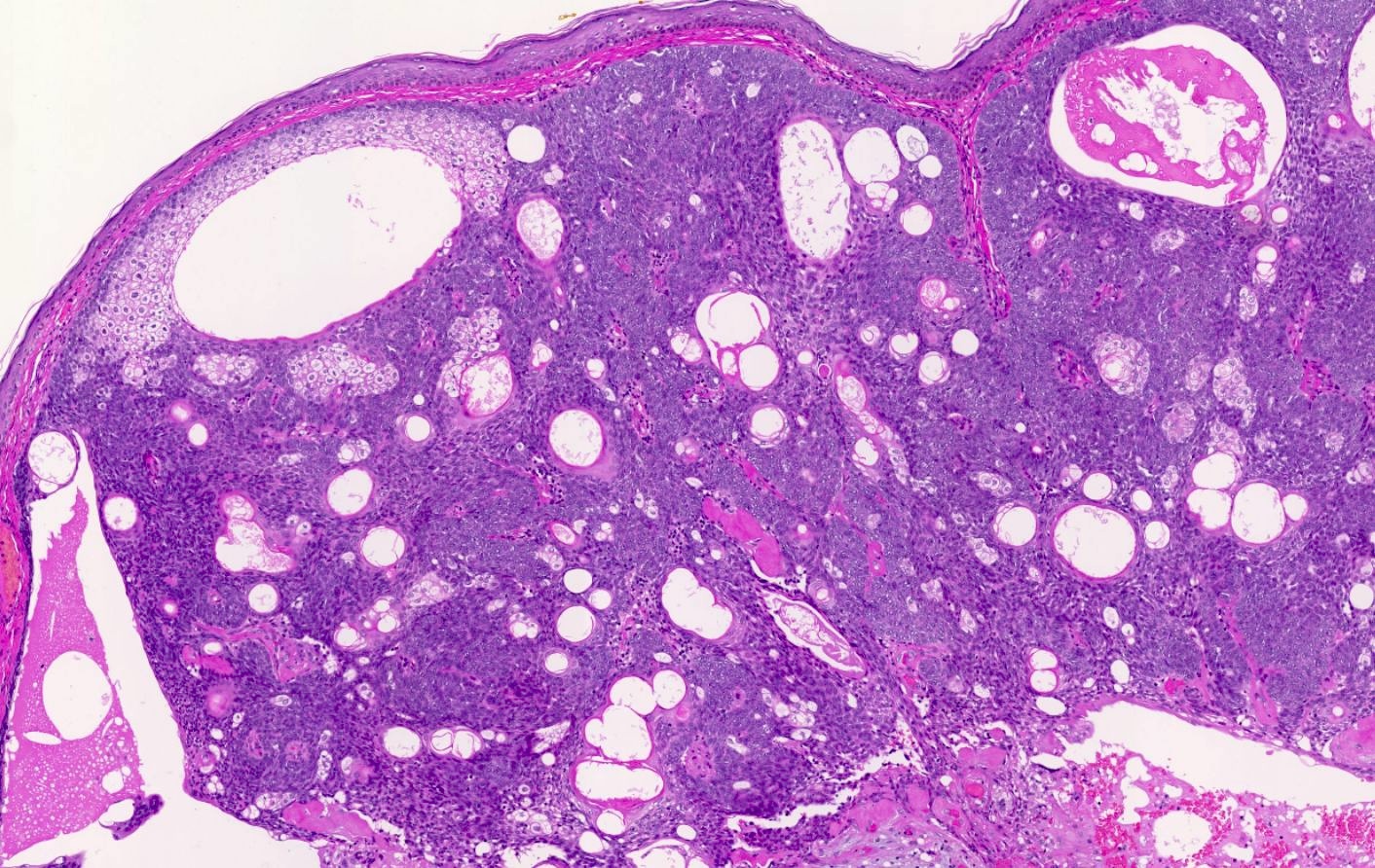 Pathology Outlines - Adipophilin