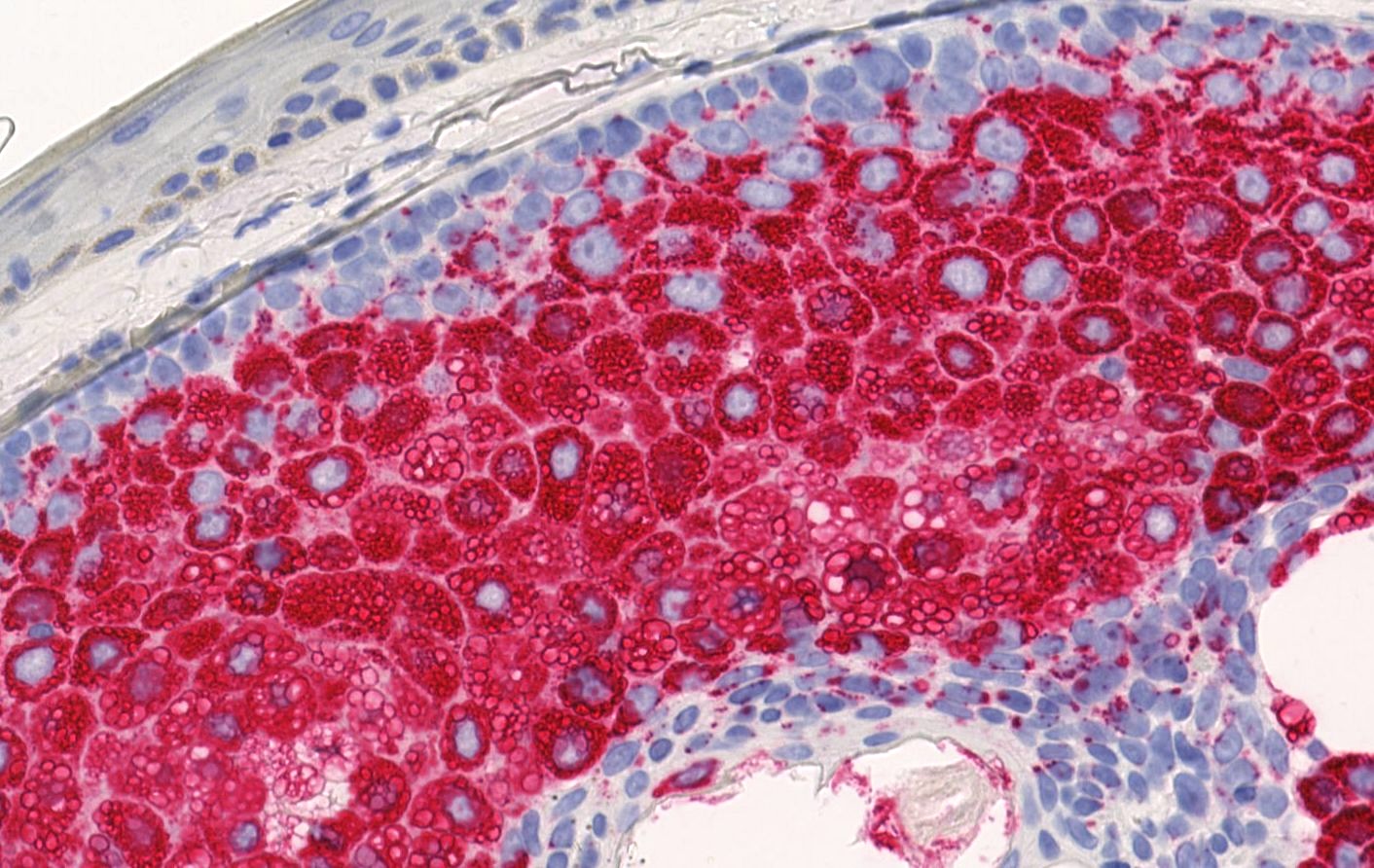 Pathology Outlines - Adipophilin