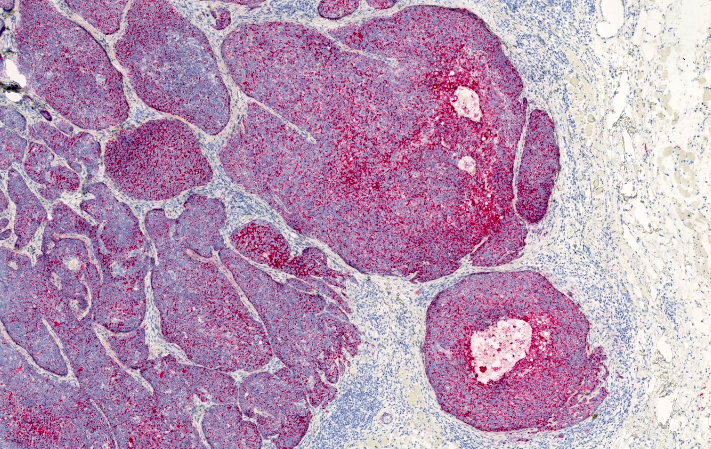 Pathology Outlines - Adipophilin