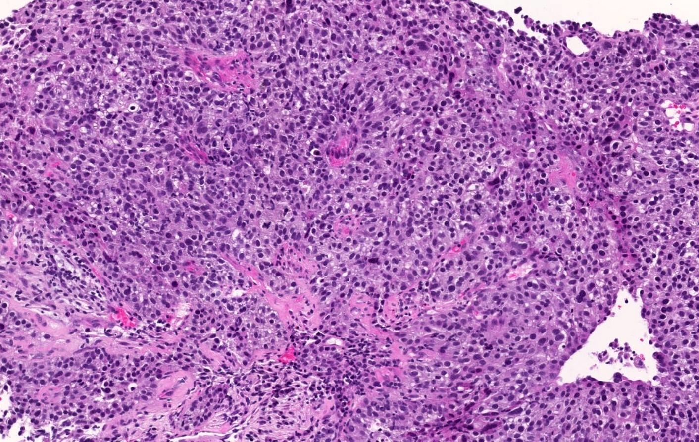 Pathology Outlines - Adipophilin