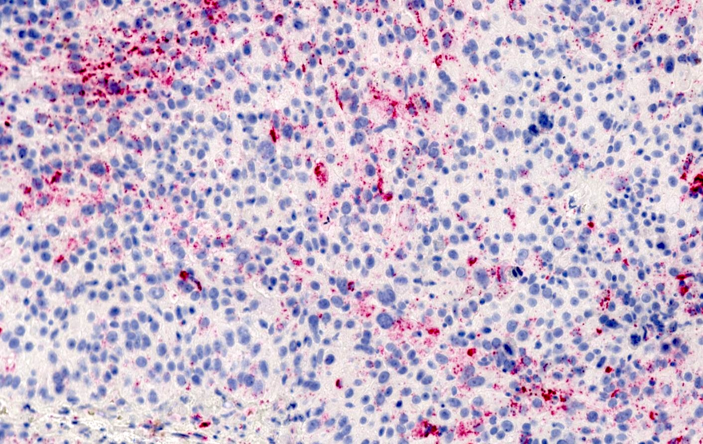 Pathology Outlines - Adipophilin