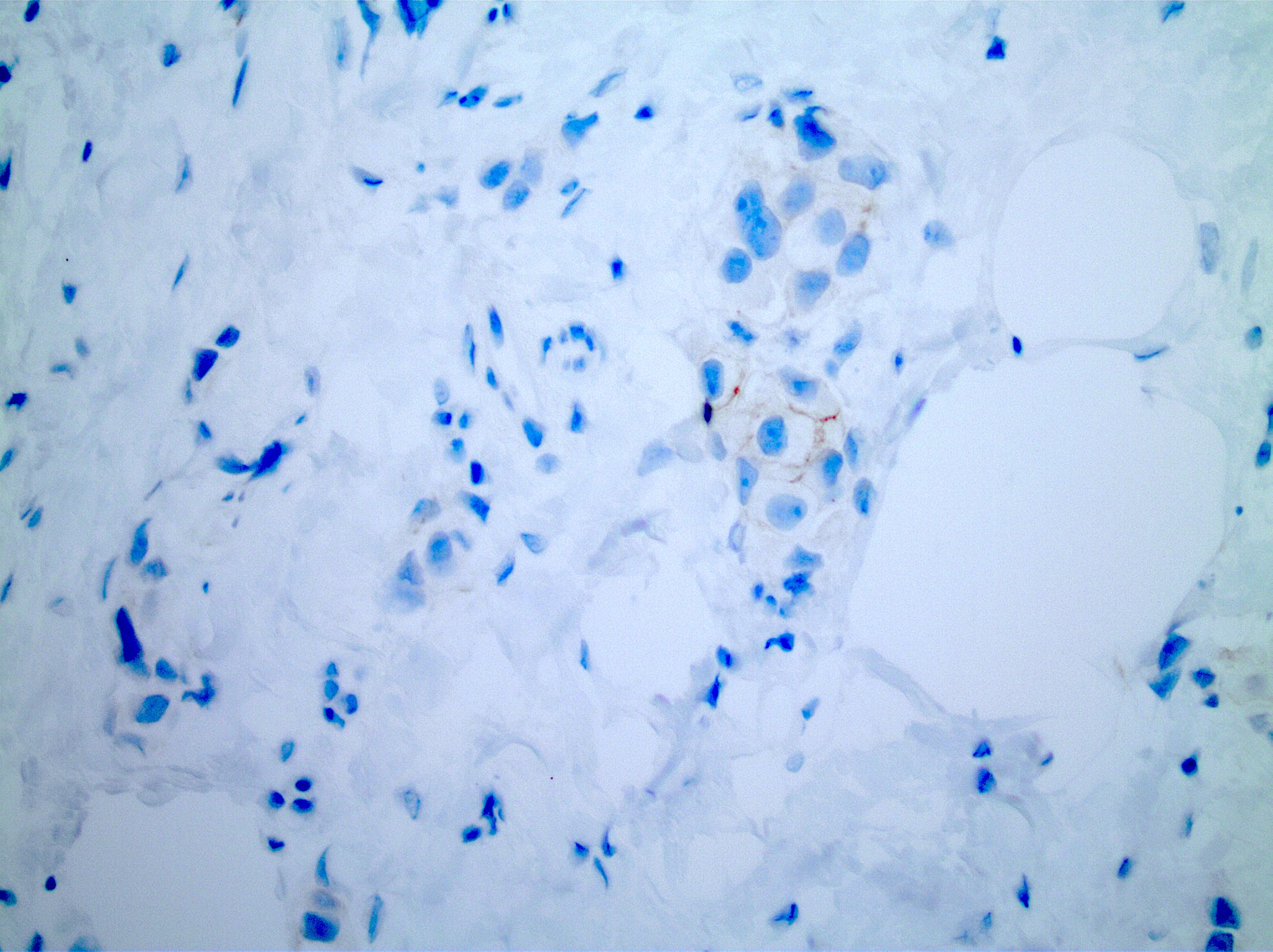 Pathology Outlines - HER2 (c-erbB2) breast