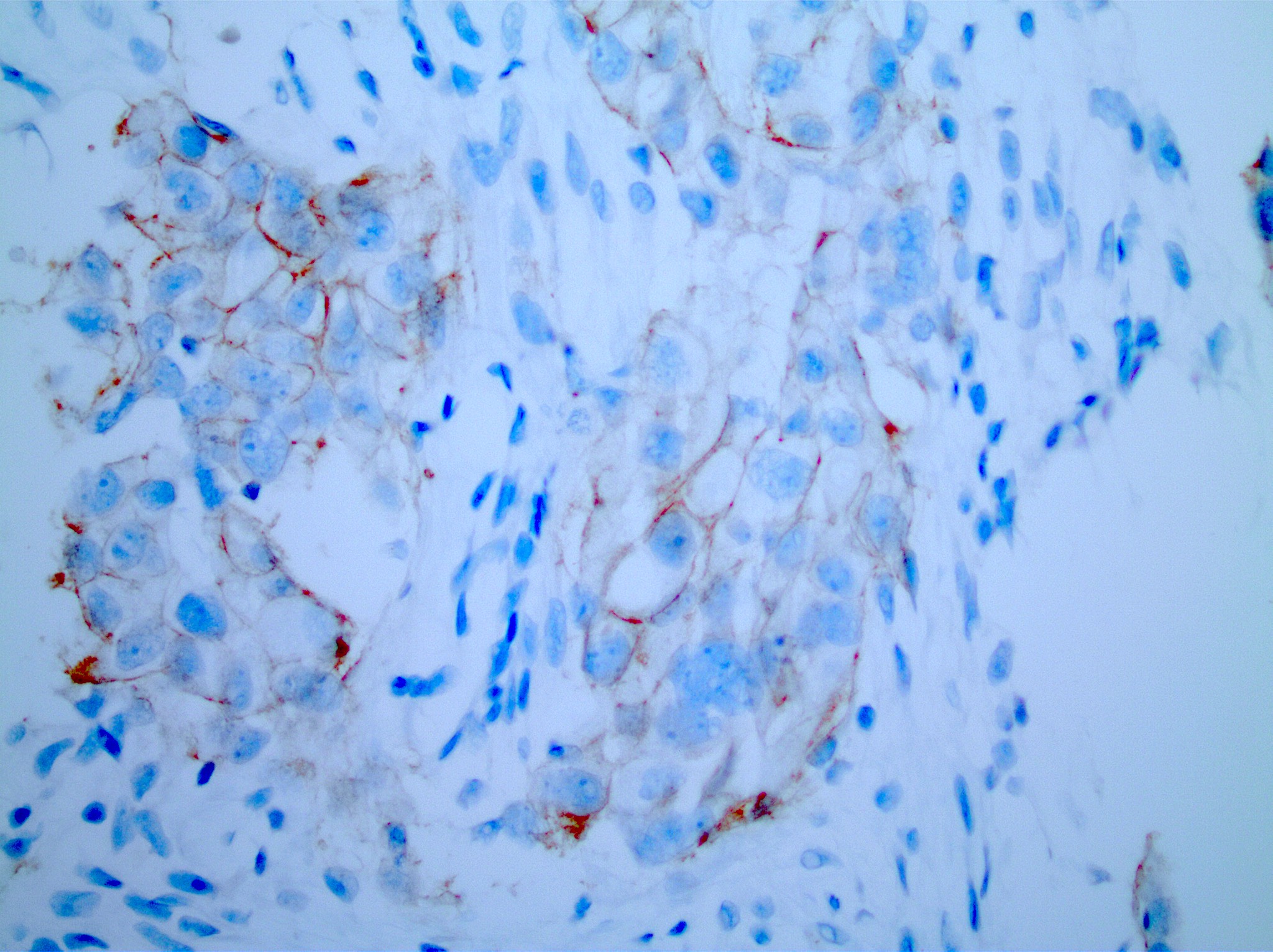 Pathology Outlines - HER2 (c-erbB2) breast
