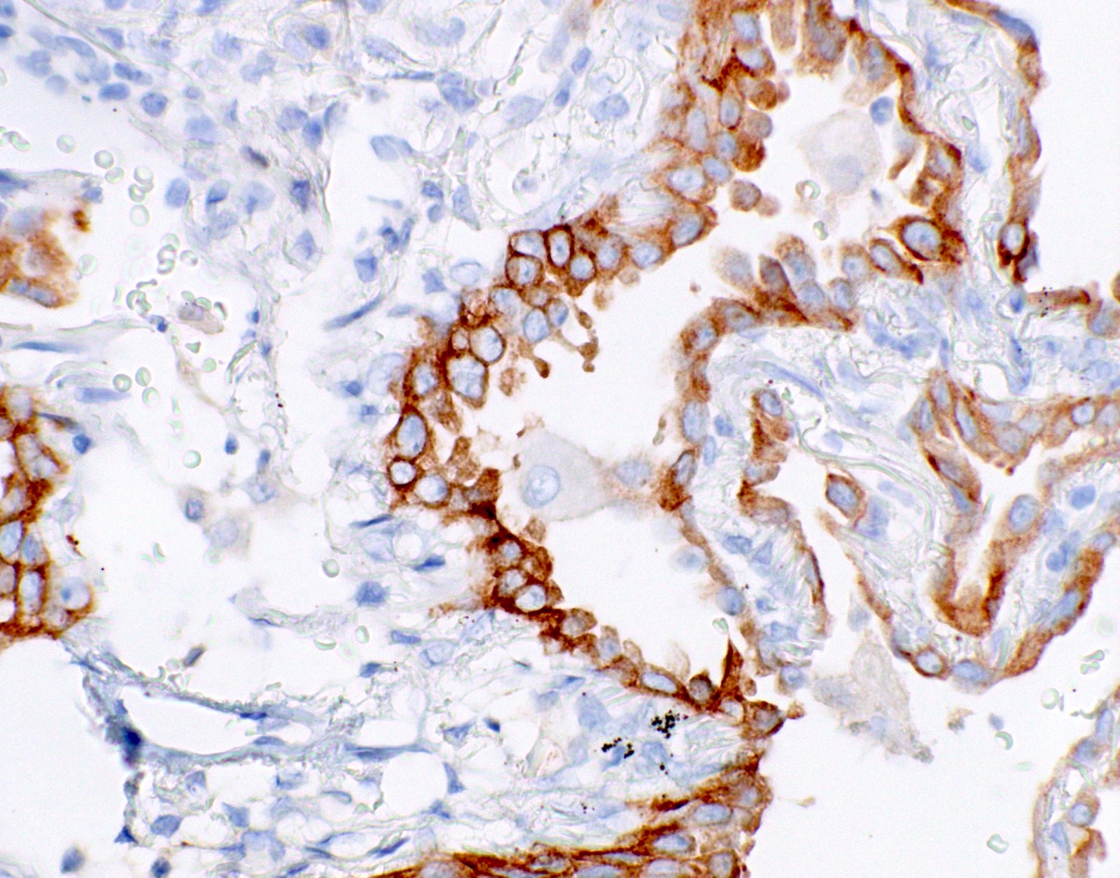 Pathology Outlines - EGFR mutation specific antibodies